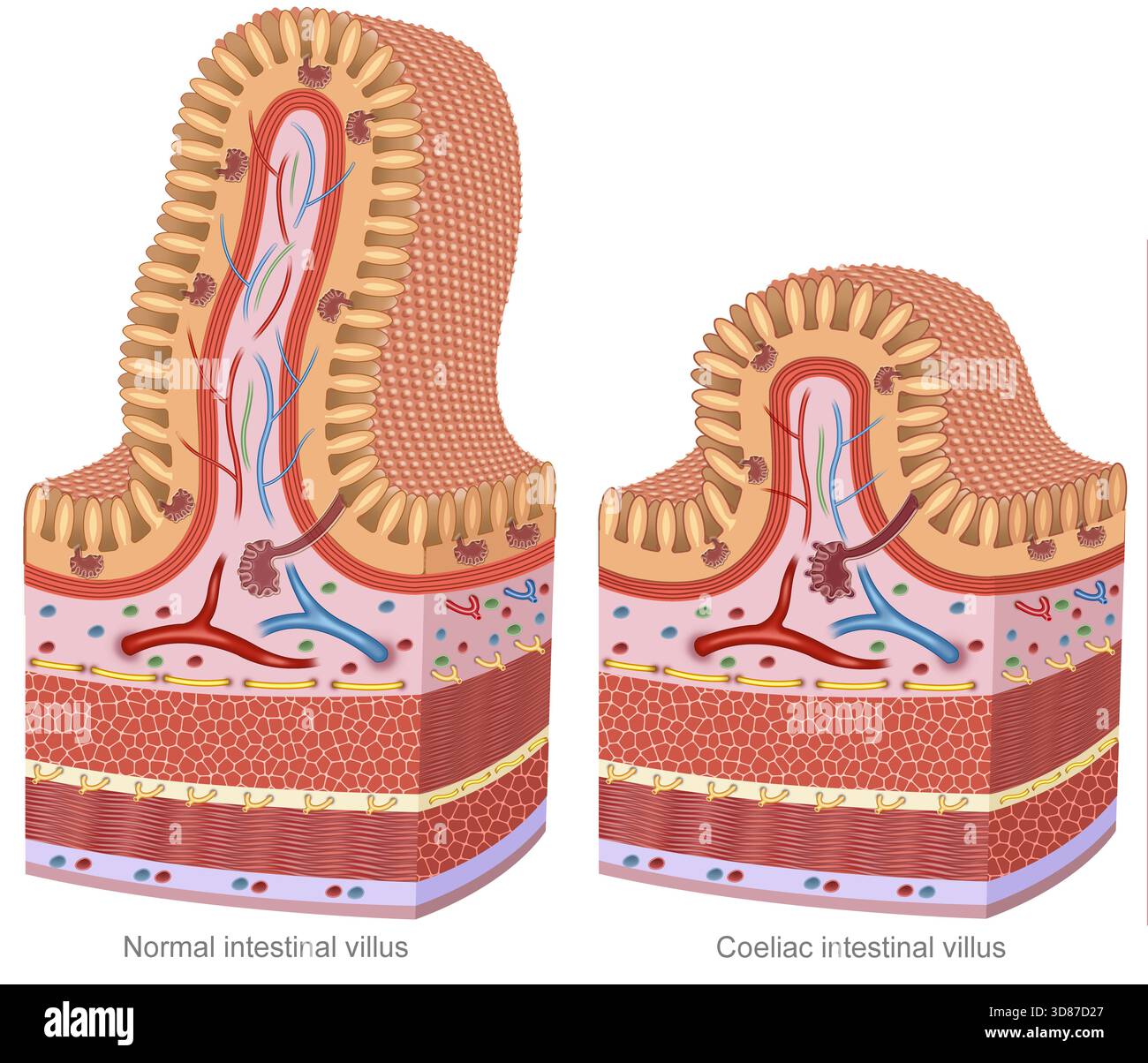 Illustration comparing the intestinal villus of a healthy person and ...