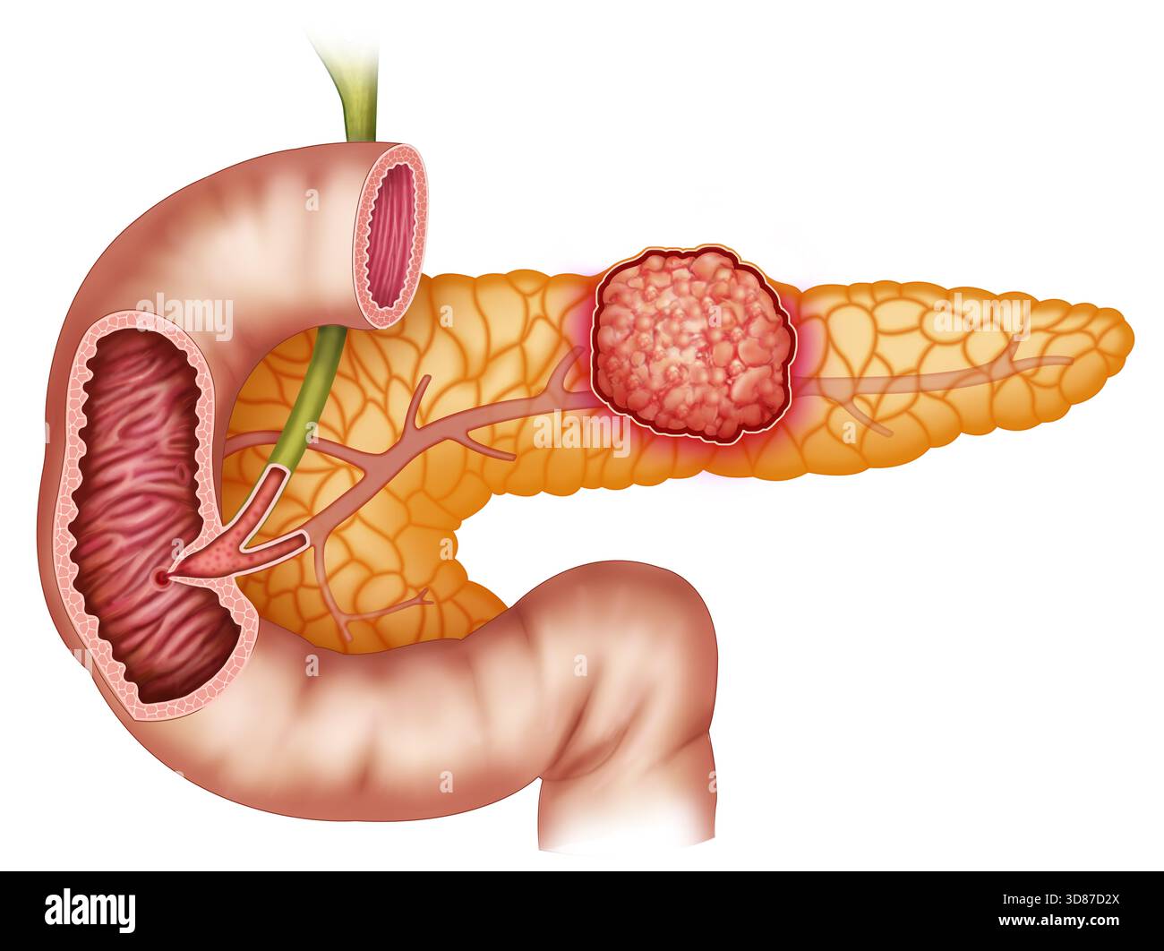 Illustration depicting pancreatic cancer, originating in the cells of ...