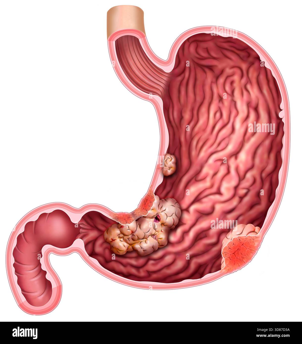 Illustration stomach cancer showing Cut Out Stock Images & Pictures - Alamy