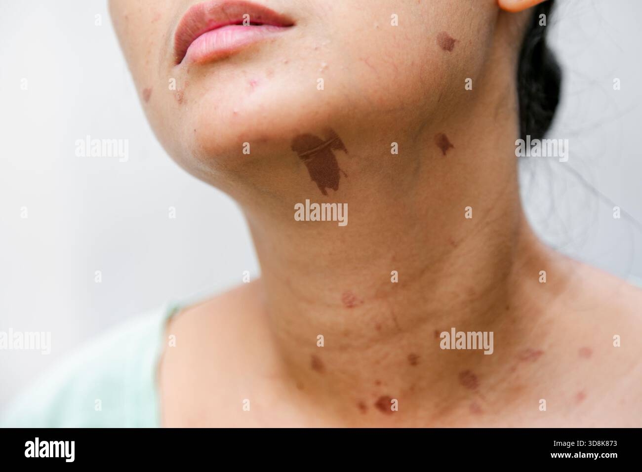 Portrait of a Southeast Asian woman with skin burn marks on her face ...