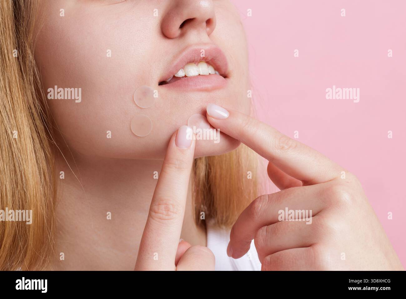 Lower face of teen girl touching transparent pimple patches on chin and ...