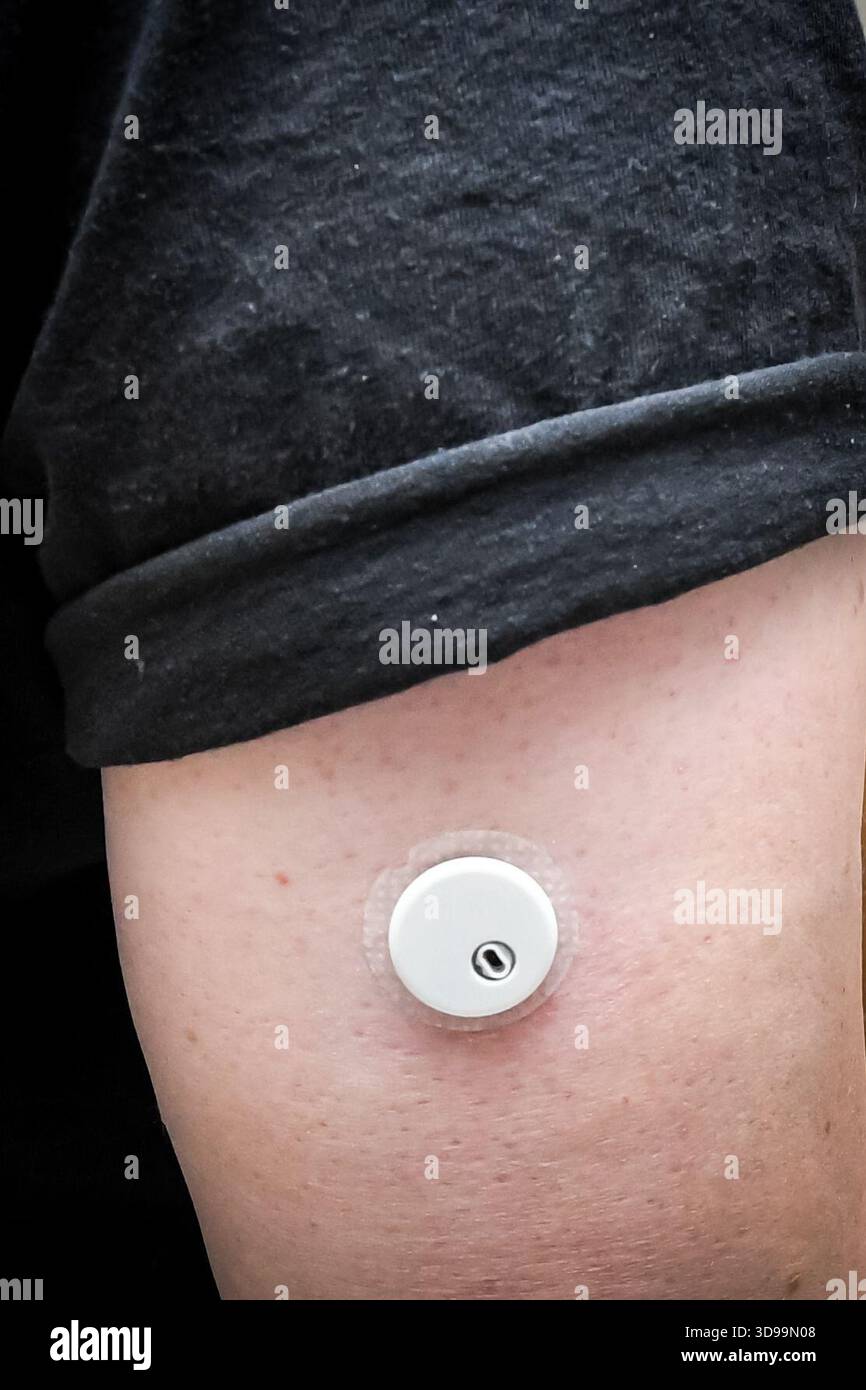 Illustration picture shows the Abbott Freestyle Libre 3 Plus glucose ...