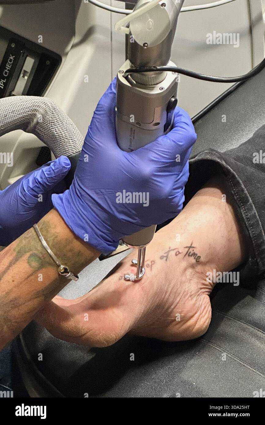 Tracy Herrmann has one of her tattoos removed by Chroma Tattoo Studio ...