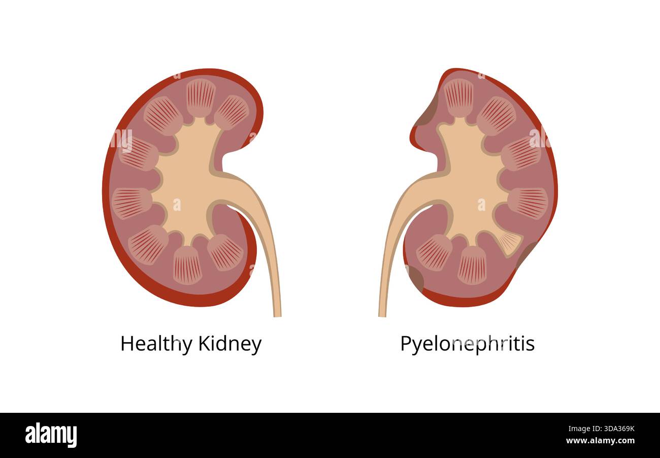 Healthy kidney and kidney with pyelonephritis, comparison and anatomy ...