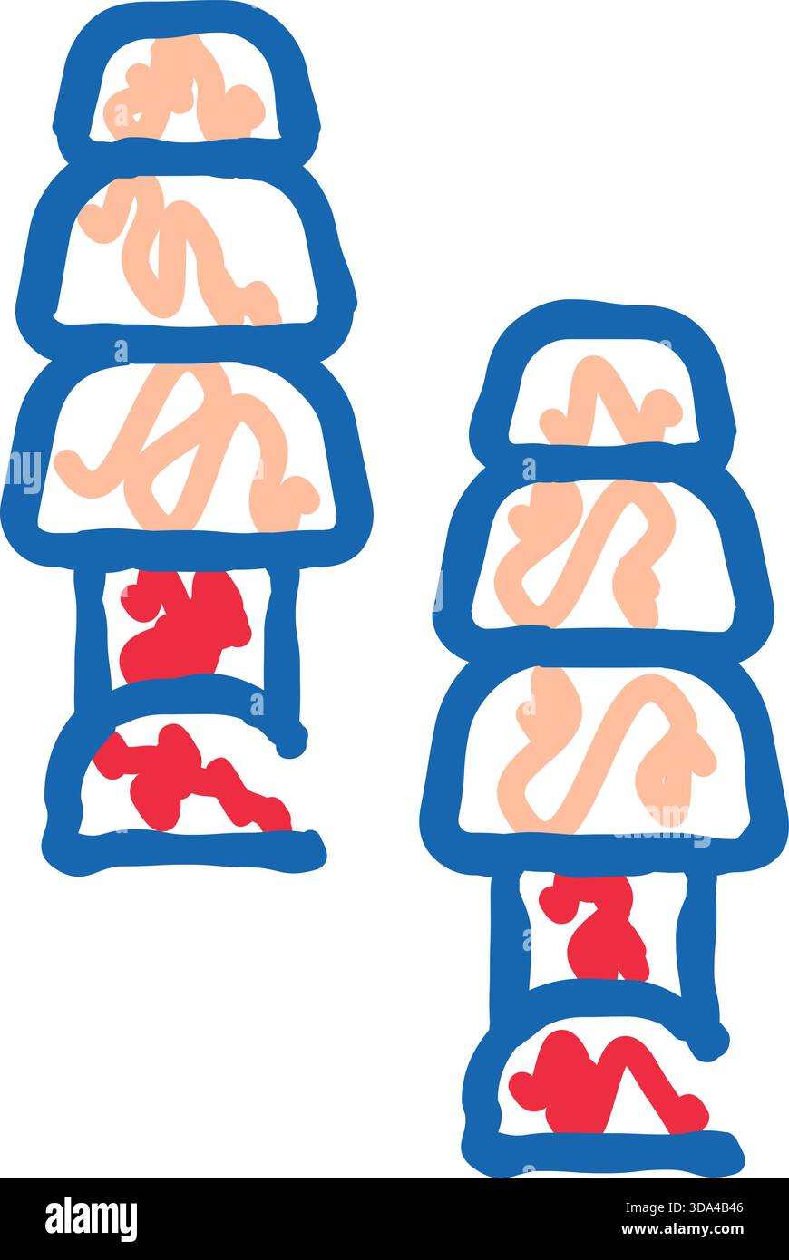 Spinal column diagram with healthy and inflamed discs Stock Vector ...