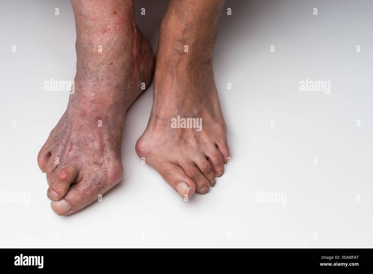 Feet of senior woman showing visible effects of bunion and hallux ...
