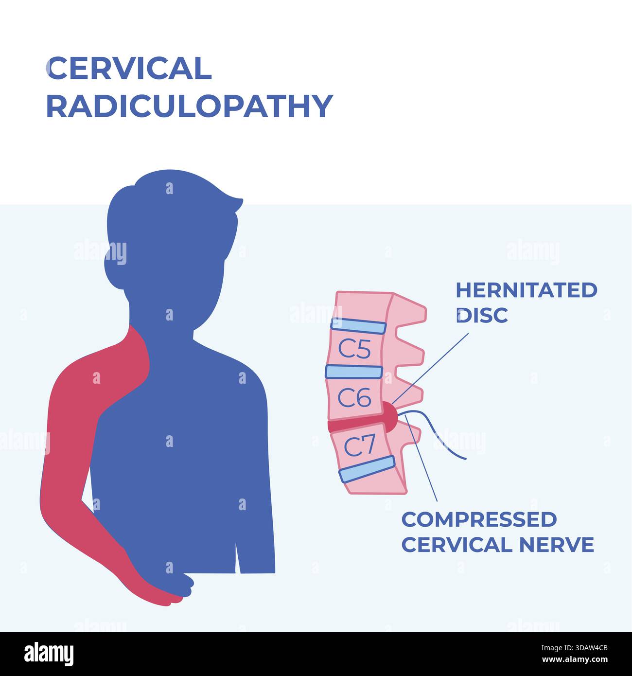 Medical vector illustration showing cervical radiculopathy caused by a ...
