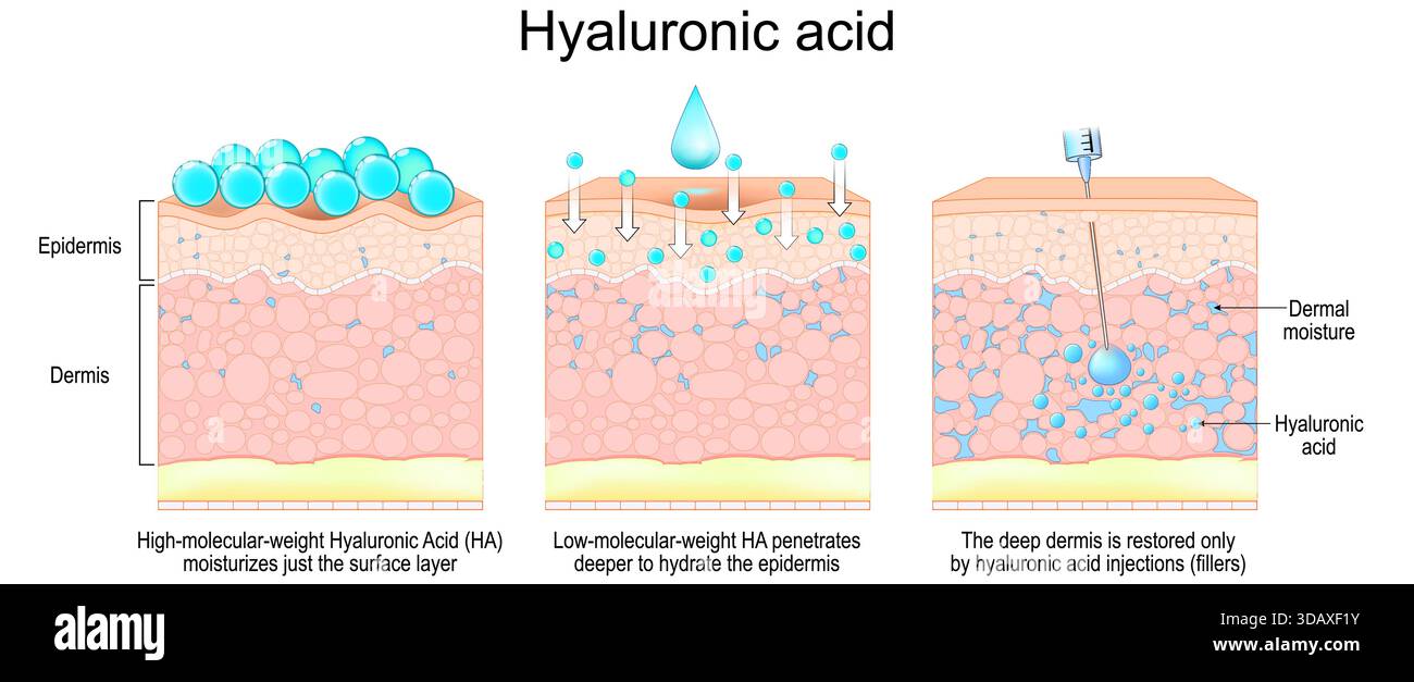 Hyaluronic acid and Dermal moisture. Skin benefits after filler ...
