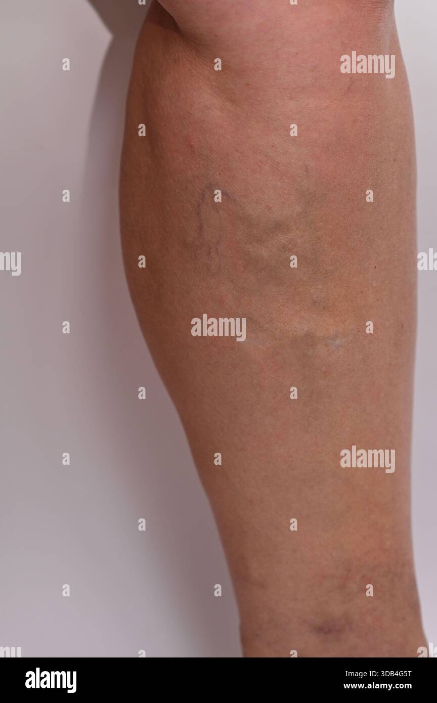 leg with mild varicose veins and visible vascular mesh. symptoms of ...