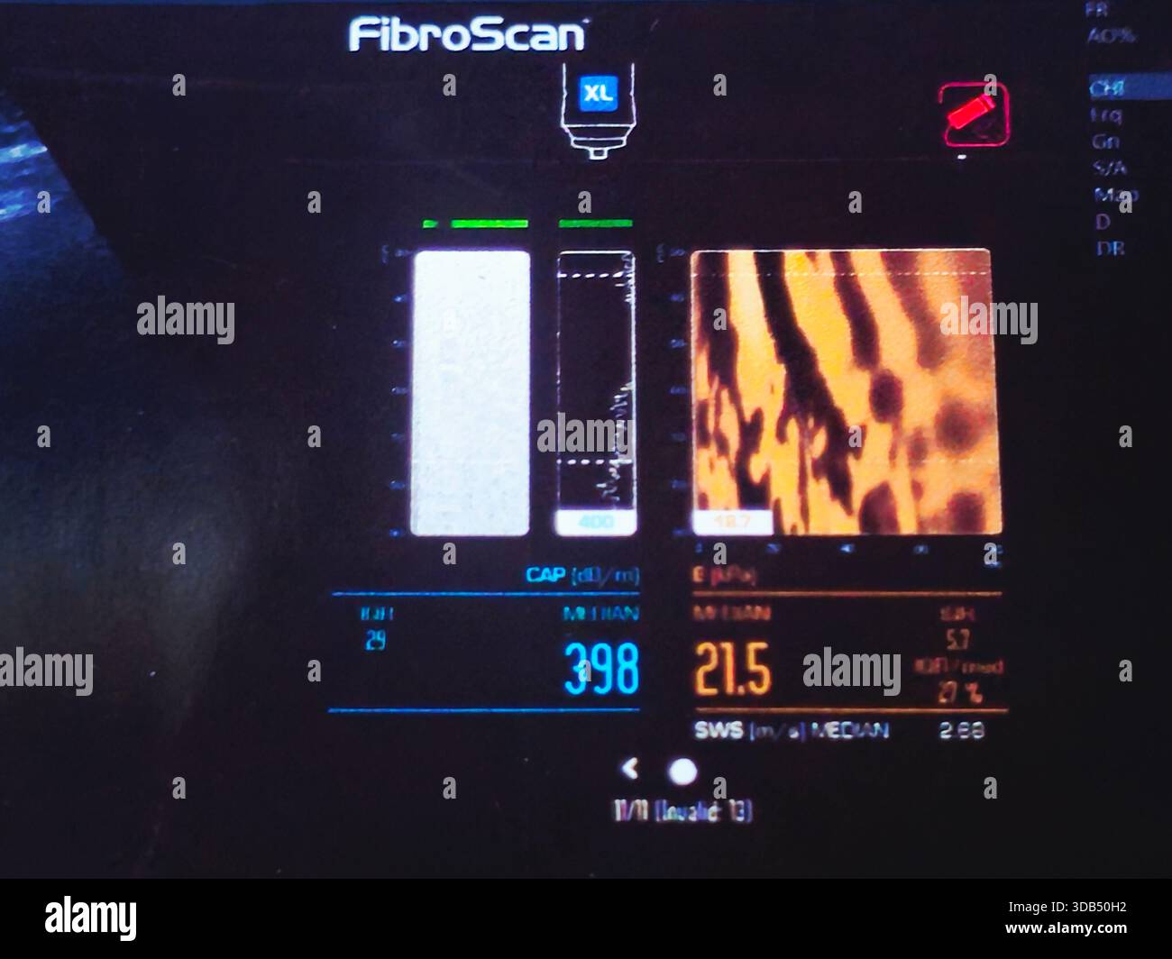 Cairo, Egypt, December 3 2025: Fibroscan examination study of the liver revealed F4 for liver ...