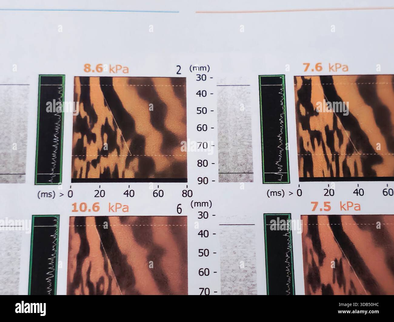 Cairo, Egypt, December 3 2025: A Fibroscan examination study of the liver revealed F2 for liver ...