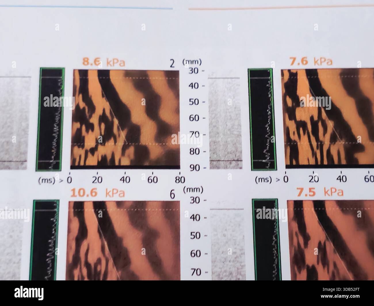 Cairo, Egypt, December 3 2025: A Fibroscan examination study of the liver revealed F2 for liver ...