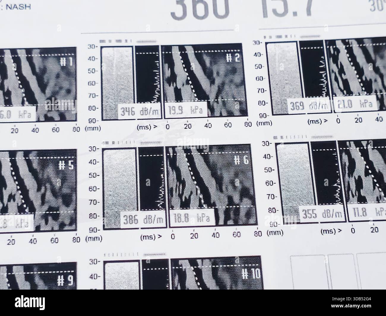 Cairo, Egypt, December 3 2025: The FibroScan study, a quick, non ...