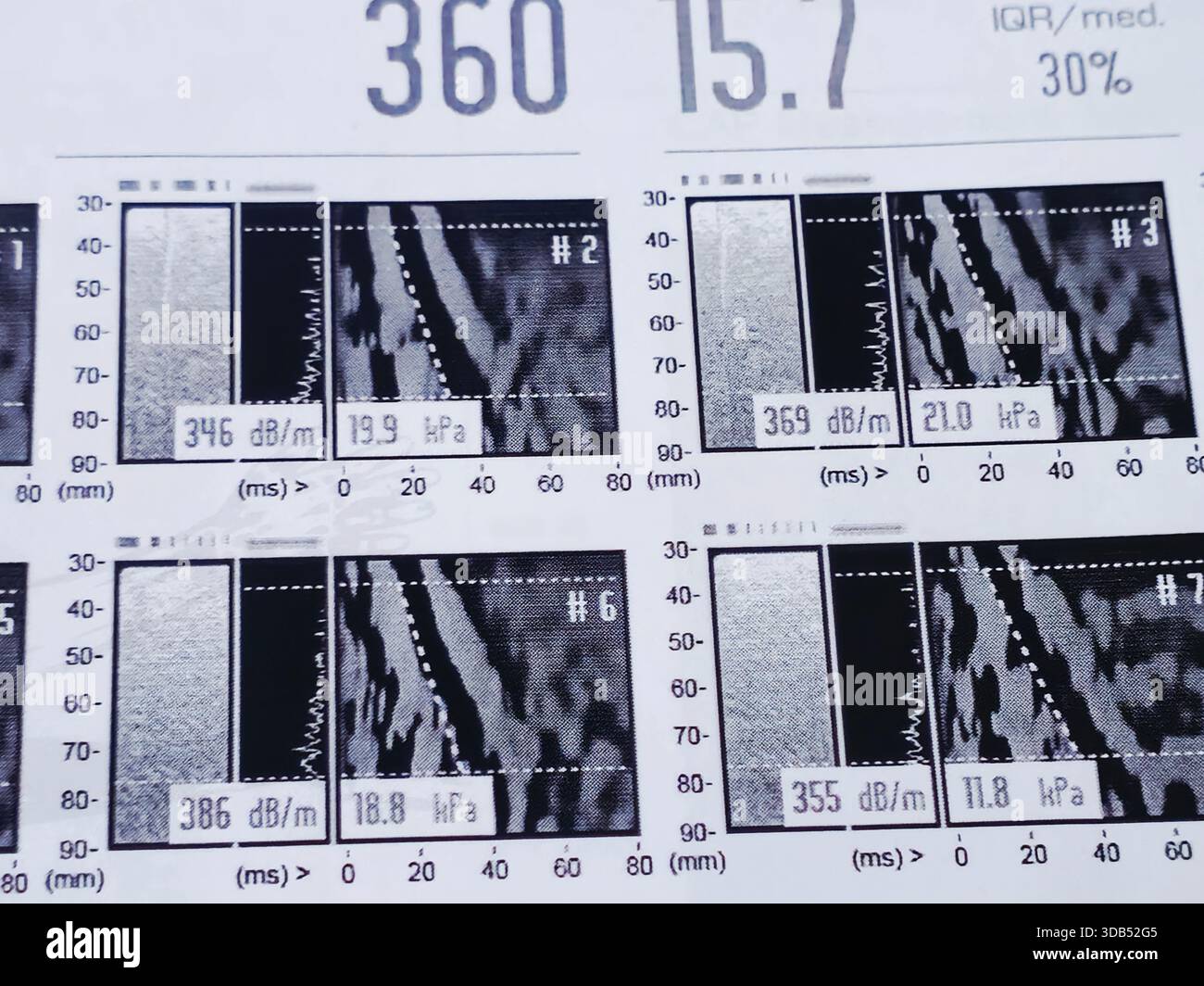 Cairo, Egypt, December 3 2025: The FibroScan study, a quick, non ...