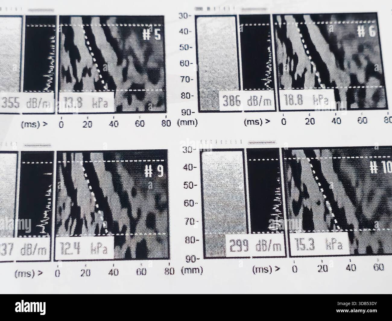 Liver stiffness hi-res stock photography and images - Alamy