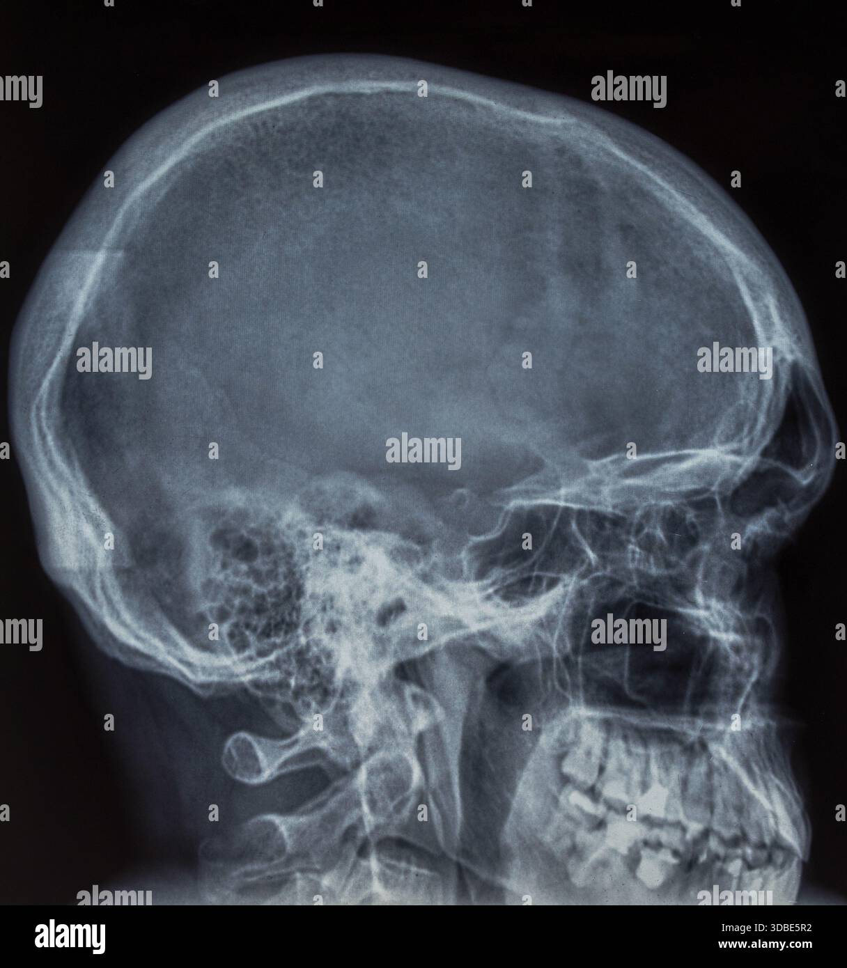 X-ray image of human skull in side view showing small cranial ...