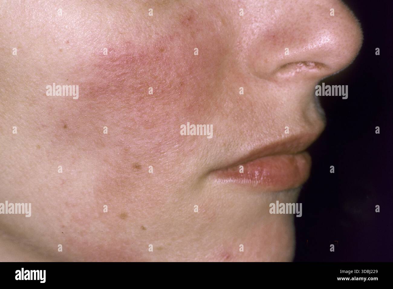 Acne rosacea on the cheek of a 31 year old woman. This condition is a ...