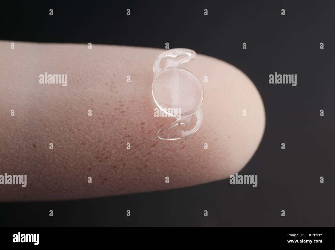 The Flexible Foldable Intraocular Lens (IOL): A Biocompatible Acrylic ...
