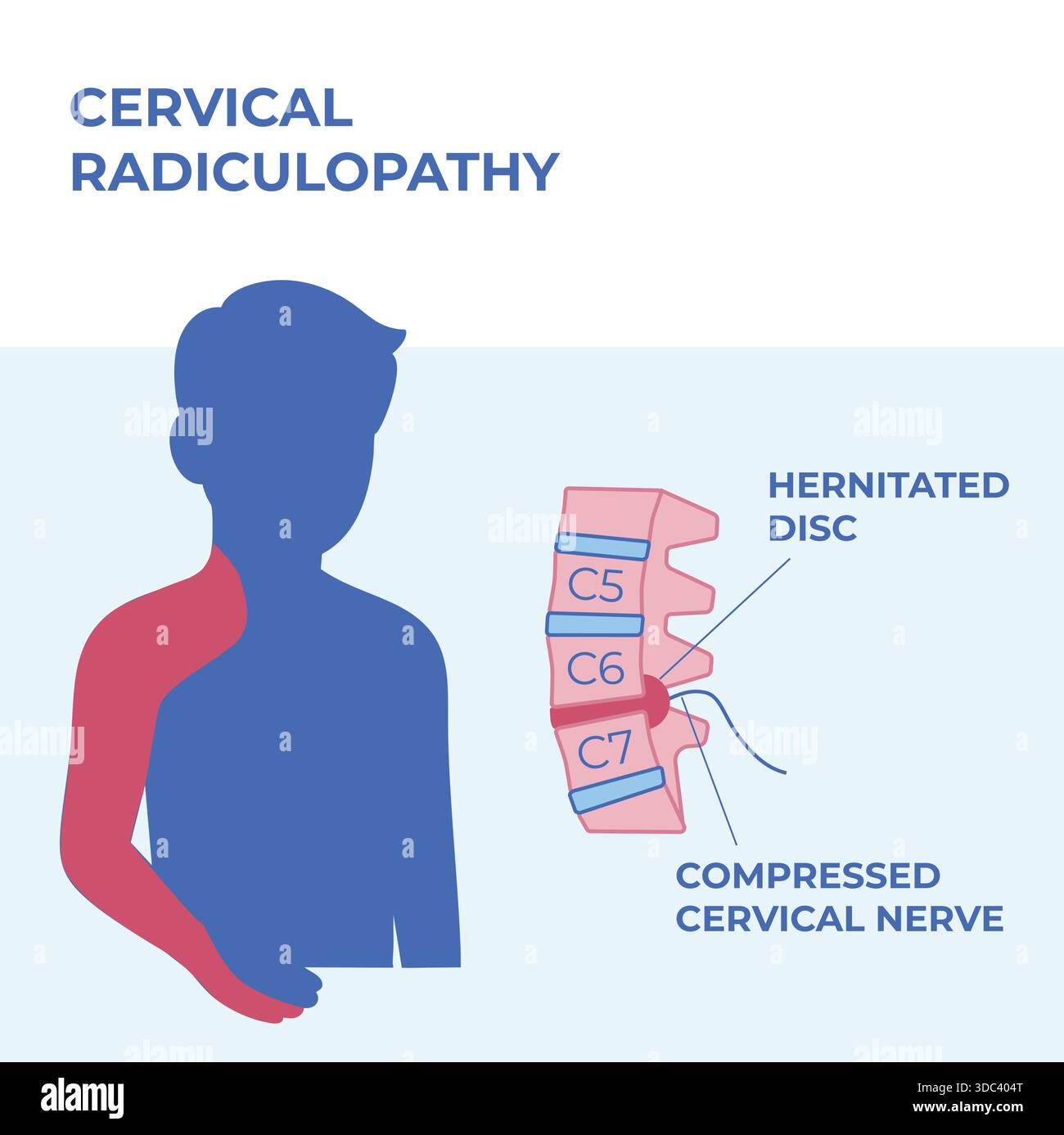 Cervical disc injury Stock Vector Images - Alamy