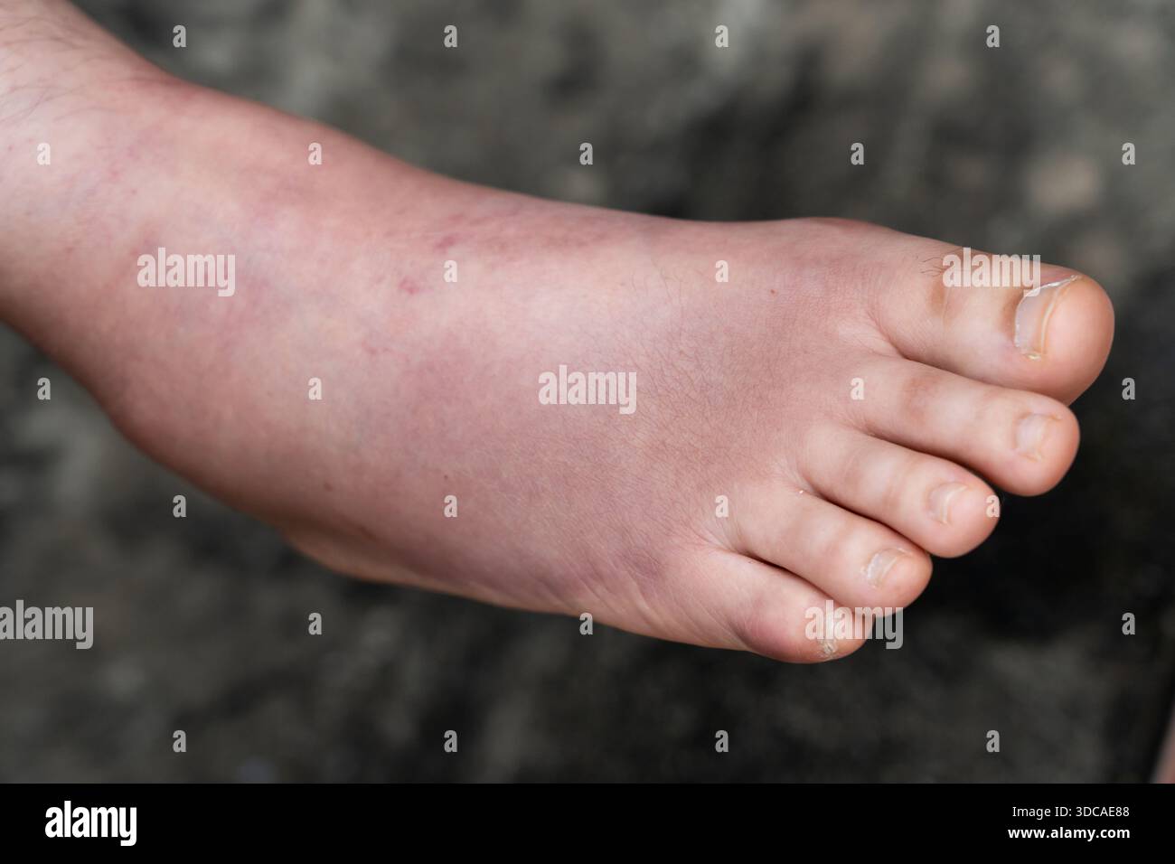 Swollen Foot After Cast Removal of Metatarsal Fracture Stock Photo - Alamy
