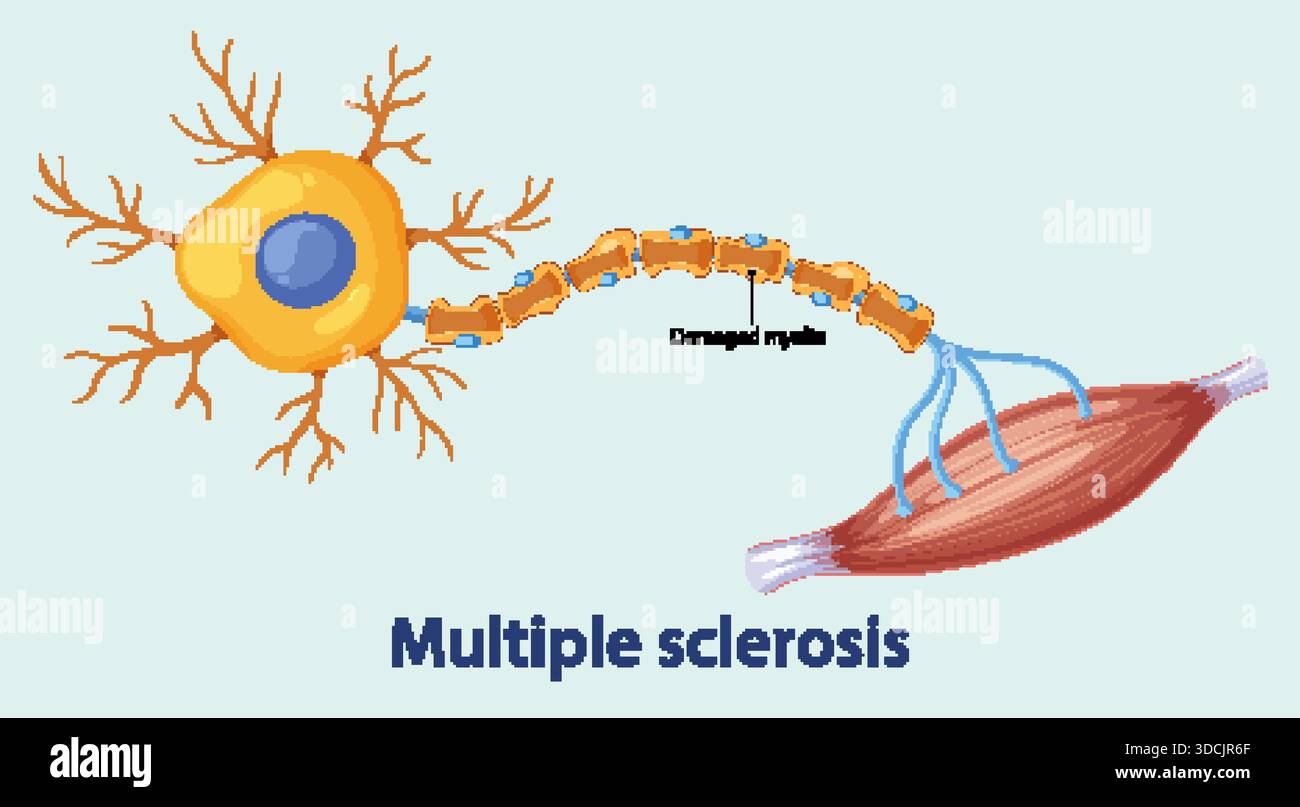 Vector diagram shows a neuron with damaged myelin sheath connecting to ...