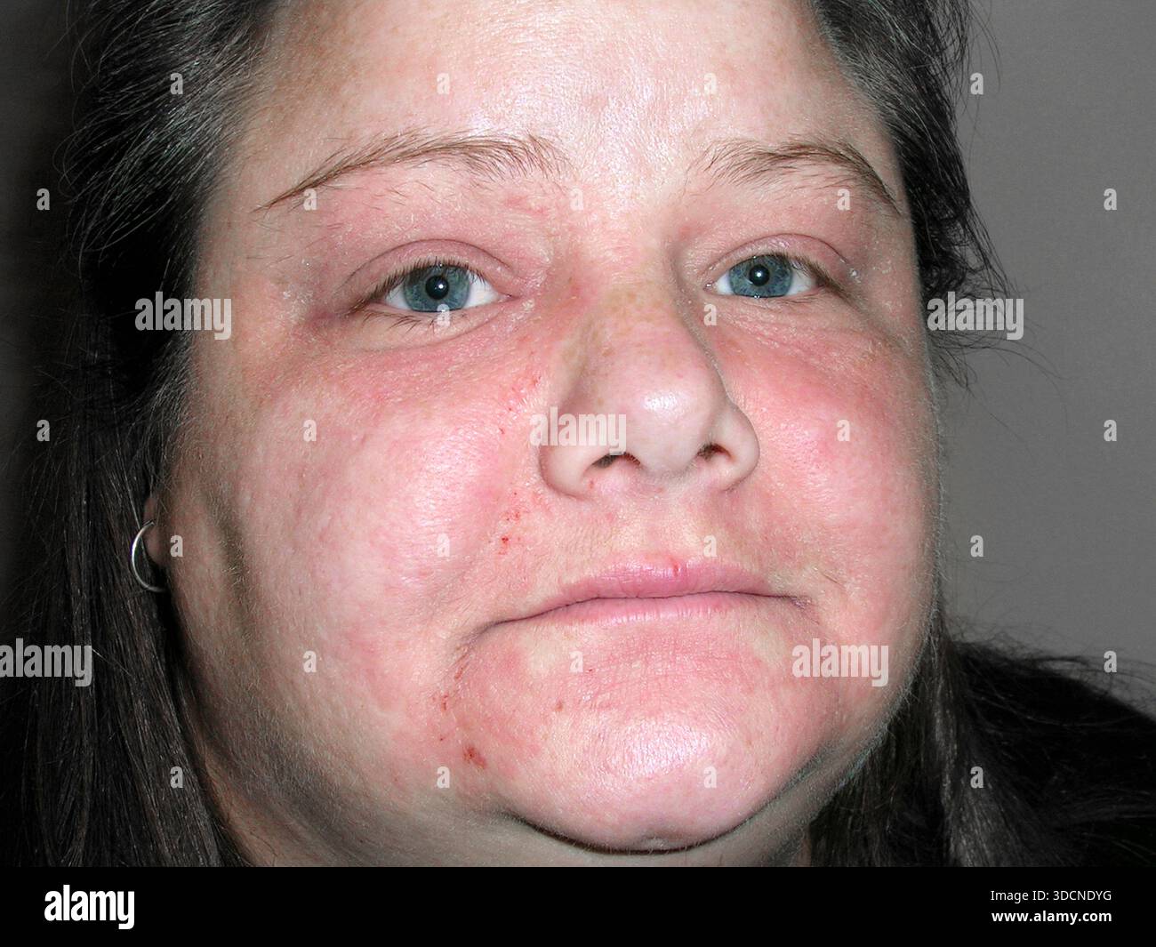 Atopic dermatitis on the face of a patient with the atopic triad ...