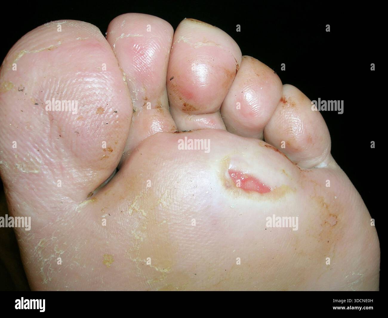 Neuropathic ulcer on the sole of the foot of a homeless man ...
