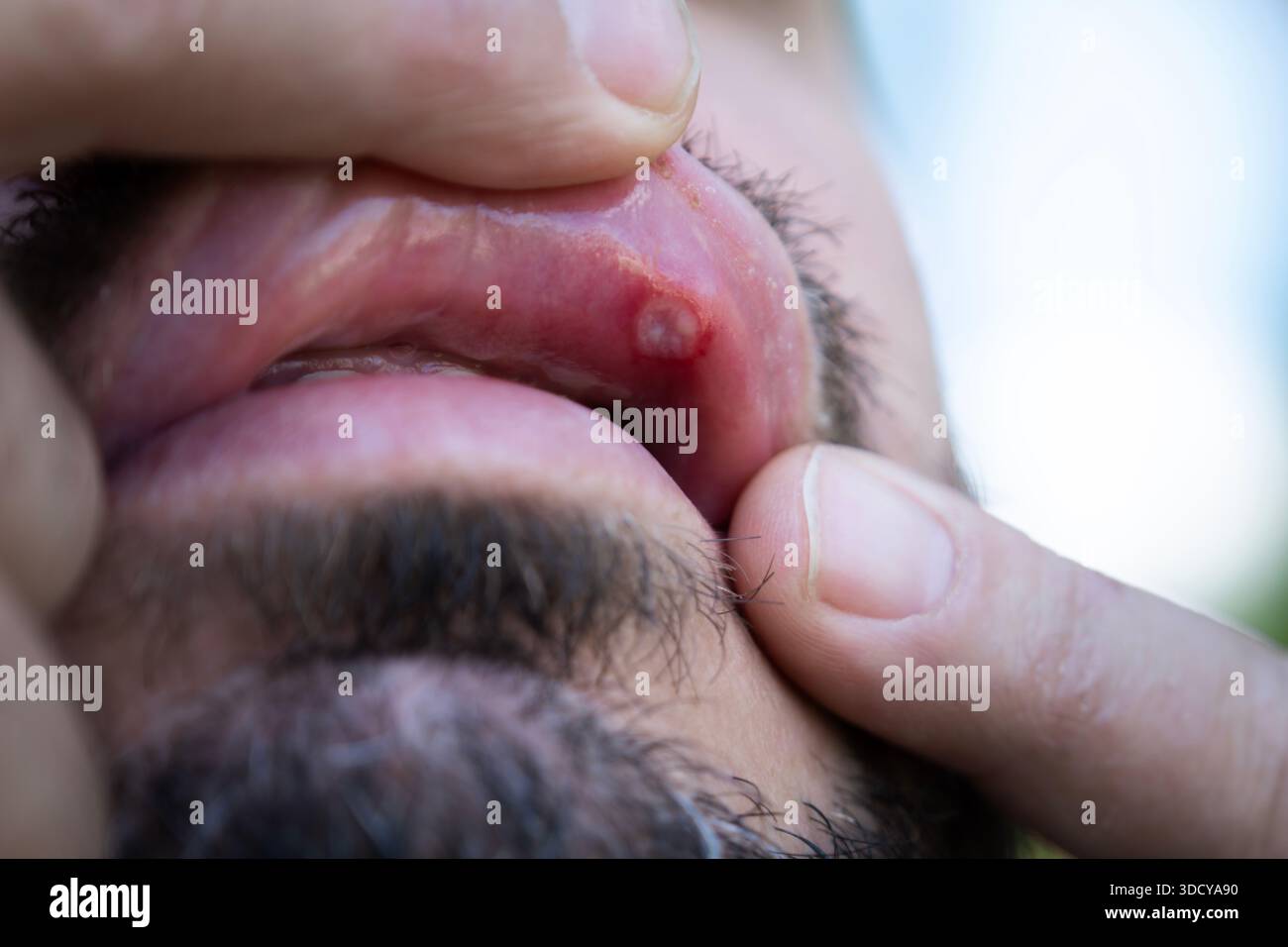 Oral candidiasis hi-res stock photography and images - Alamy