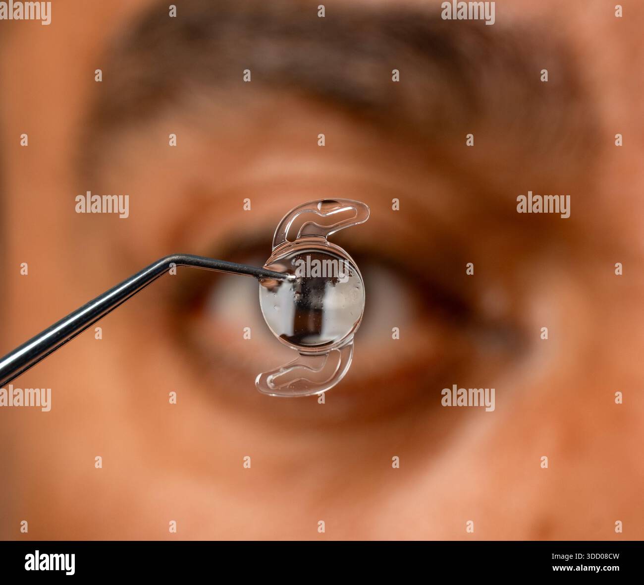 Foldable intraocular lens for cataract surgery held in front eye Stock ...