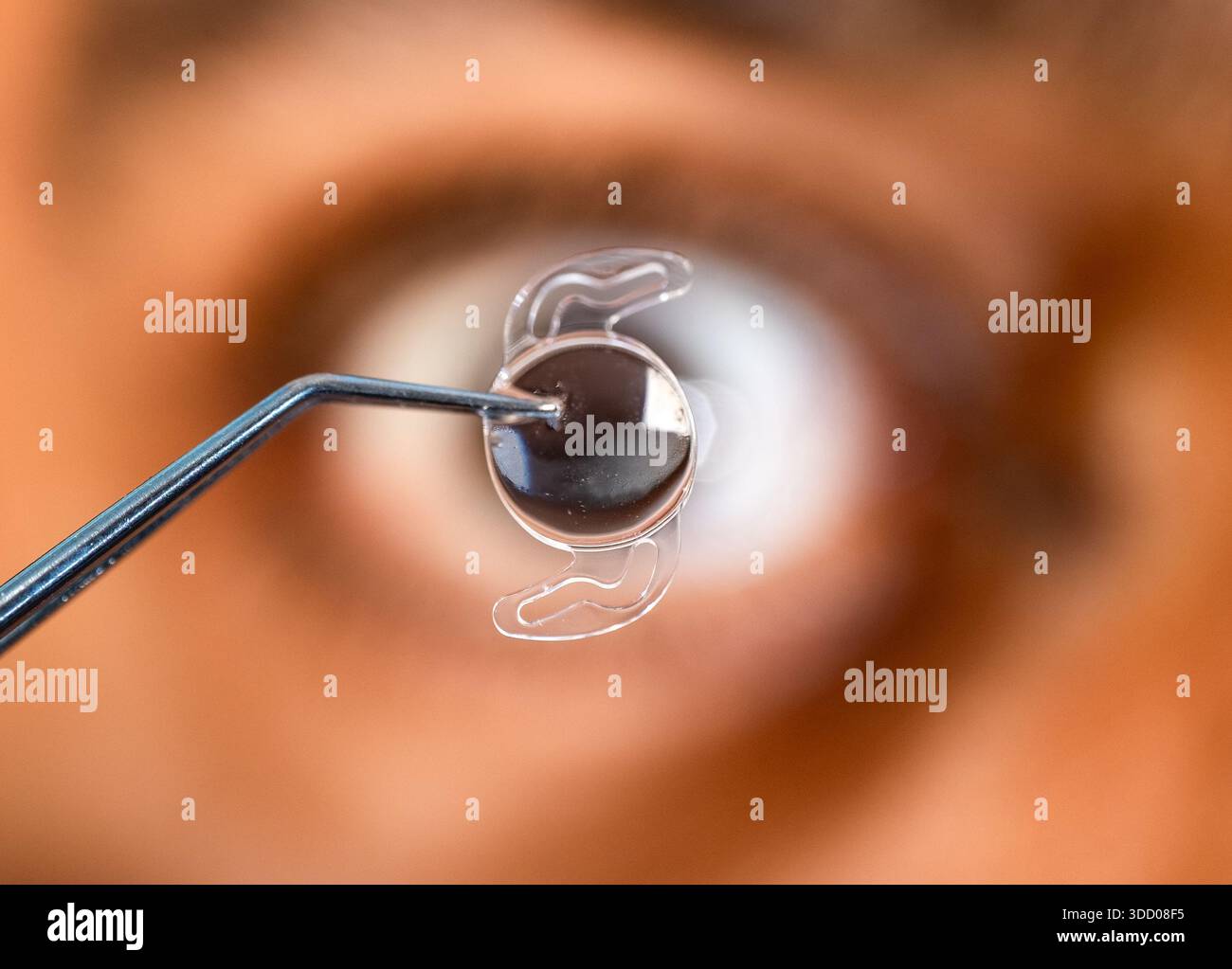 Foldable intraocular lens positioned before human eye in surgery ...