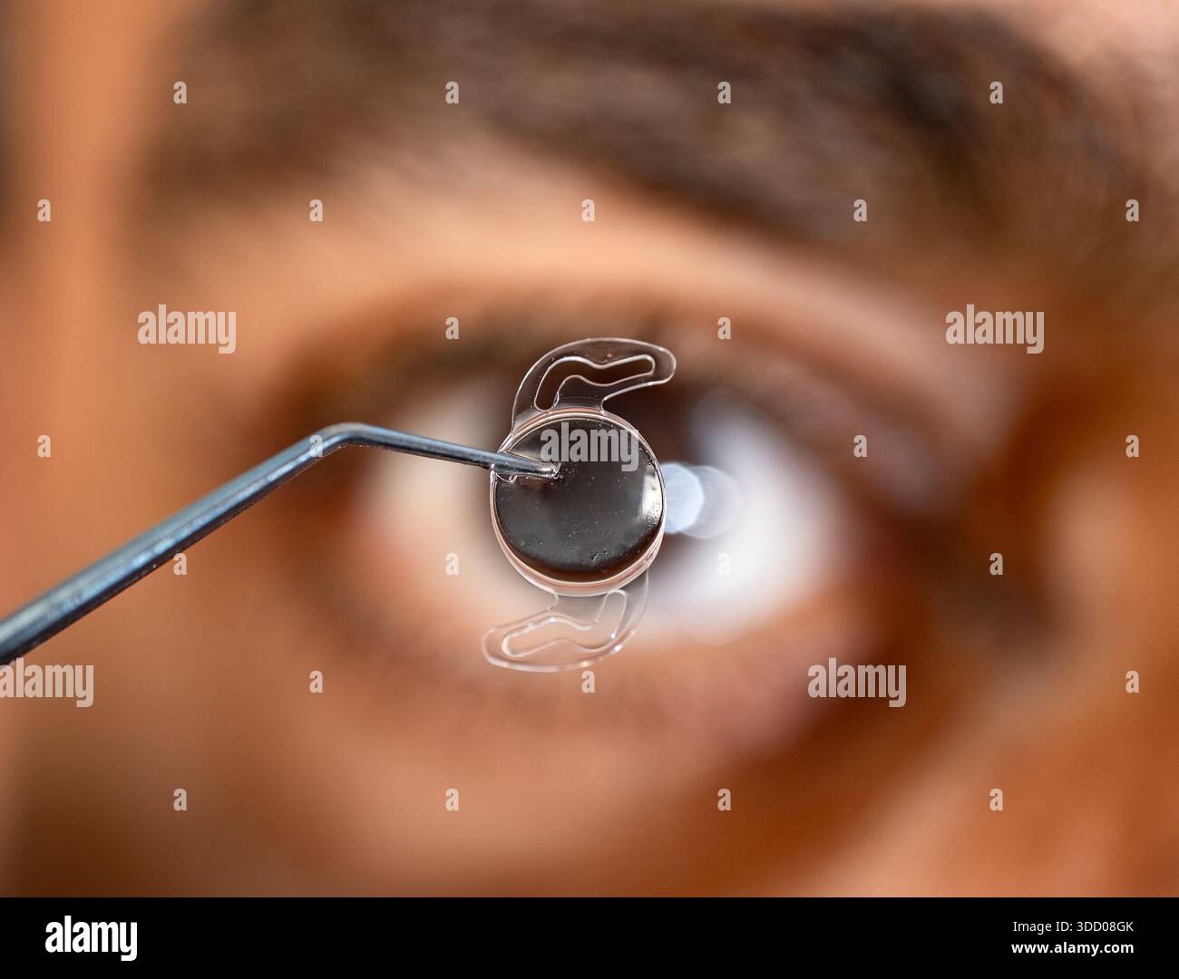 Foldable intraocular lens for cataract surgery held in front eye Stock ...