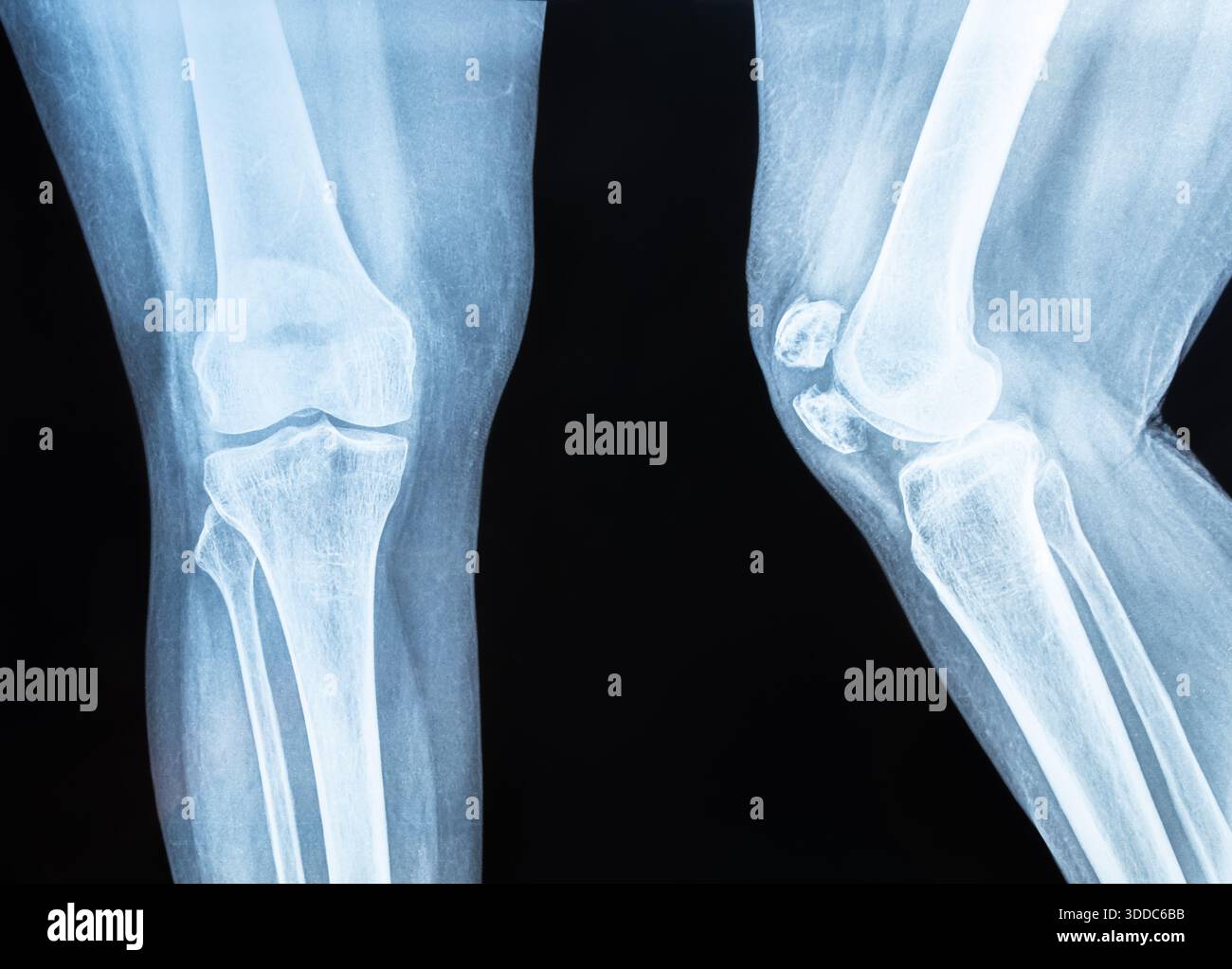 Ray image patella fracture hi-res stock photography and images - Alamy