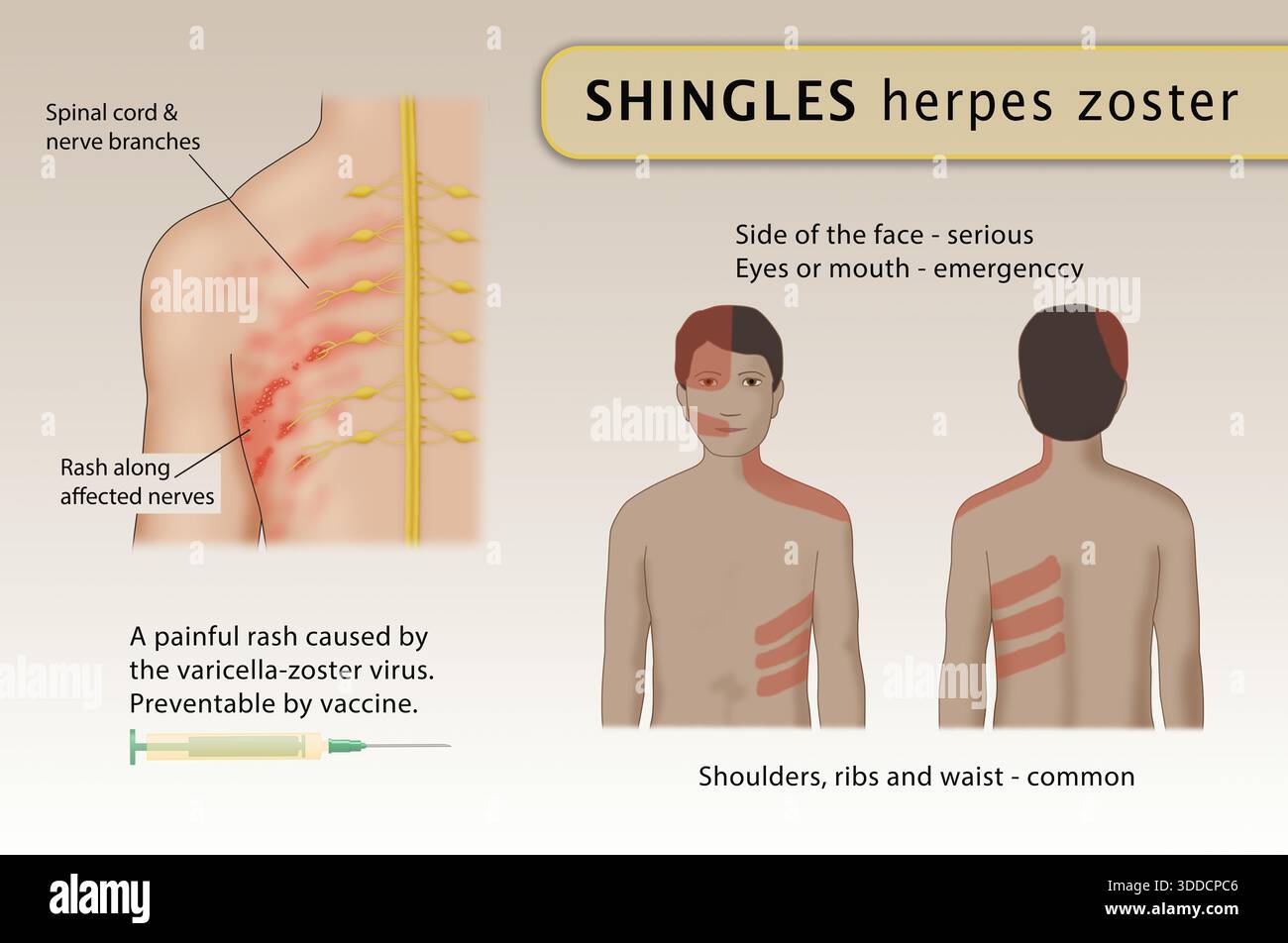 A medical illustration of the most common areas of the body for the ...