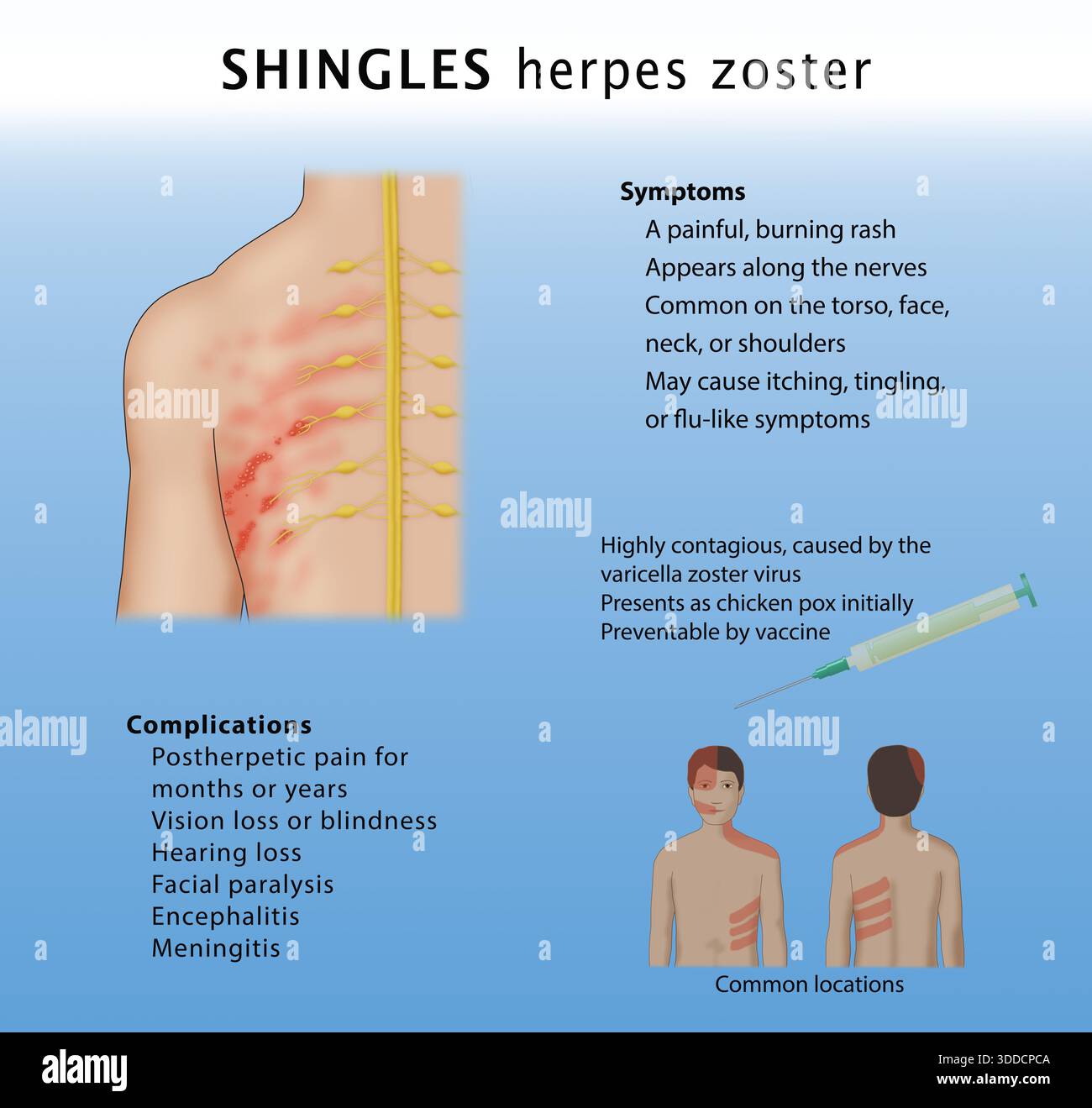 A medical illustration of the symptoms and complication of shingles ...