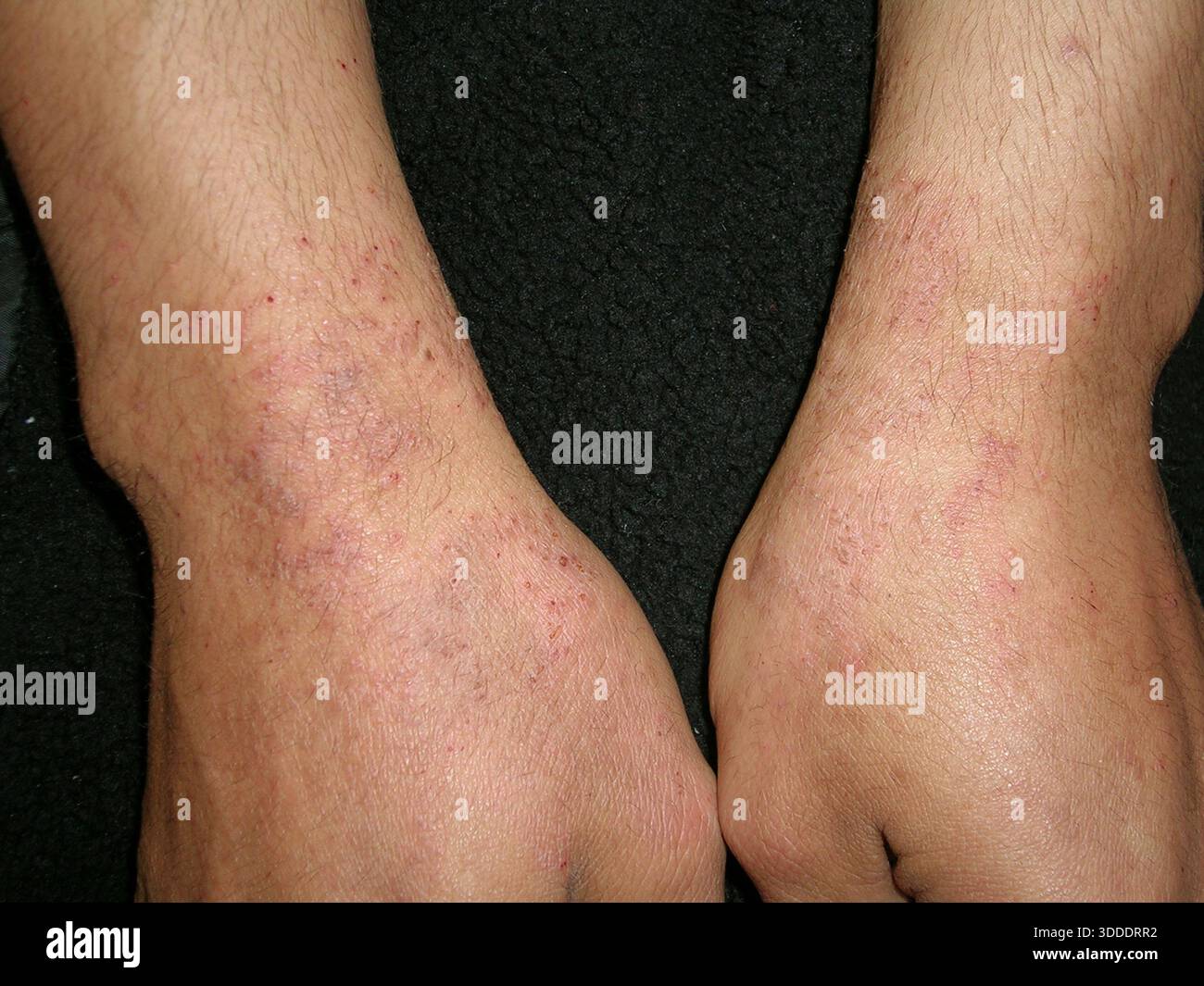 Impetigo and atopic dermatitis on a patient's wrists. Atopic dermatitis ...