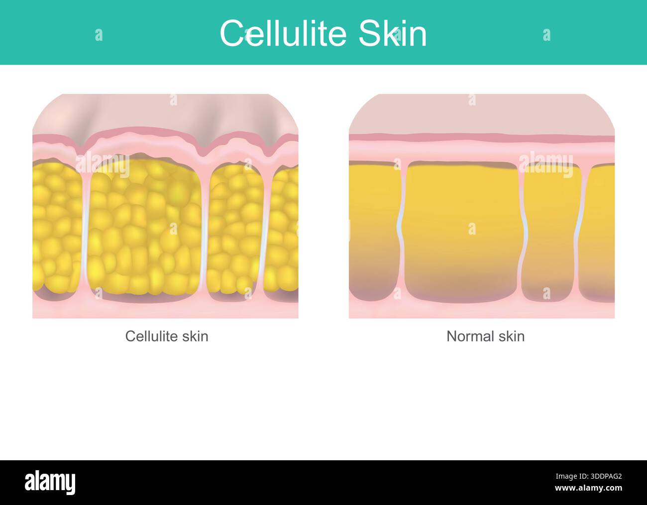 This diagram compares Cellulite Skin to Normal Skin. Cellulite is ...