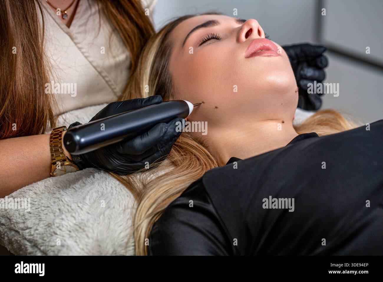 Removal of birthmark from client's chin. Close up. Concept of laser ...
