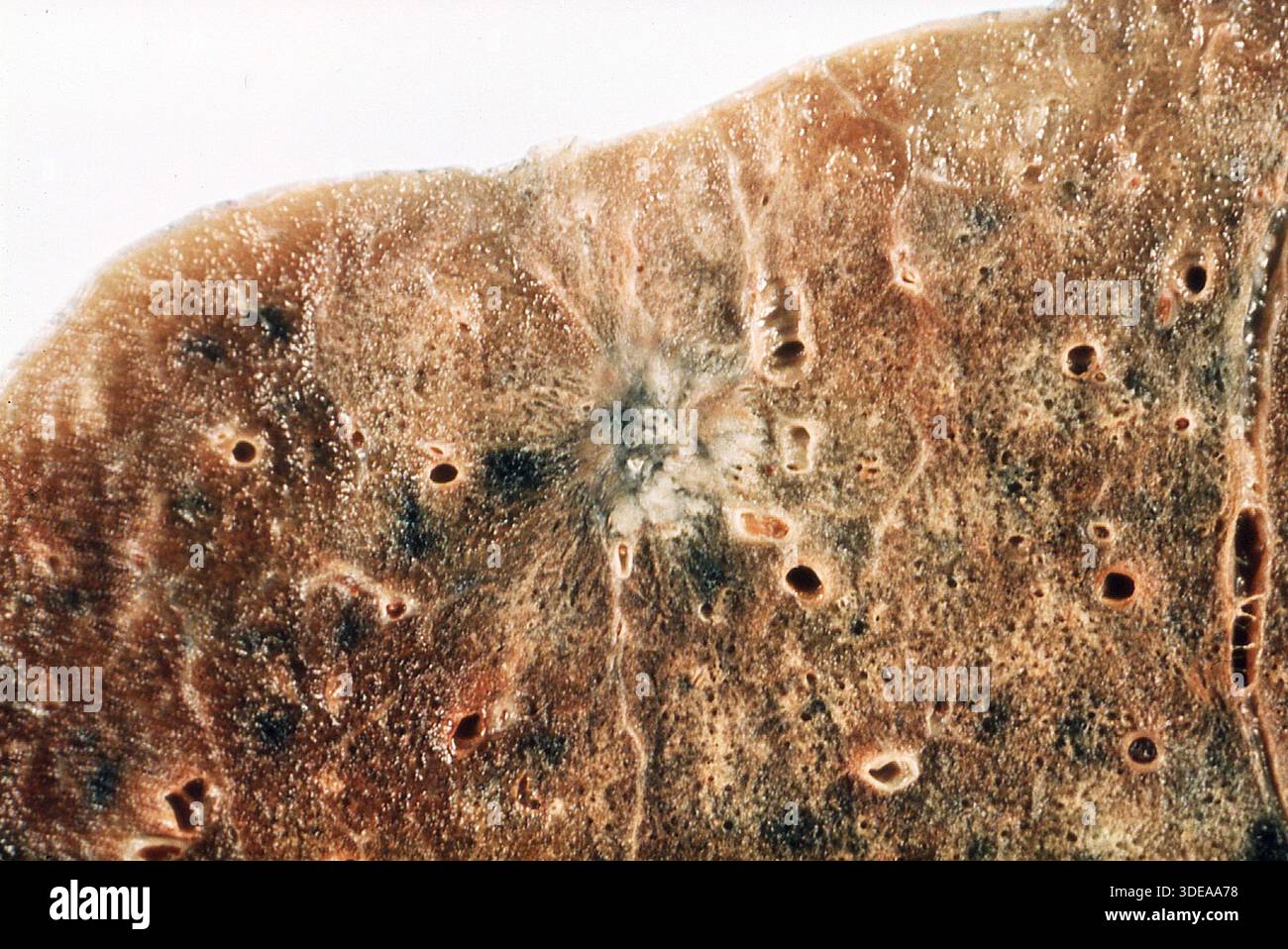 Peripheral carcinoma of the lung under the microscope Stock Photo - Alamy