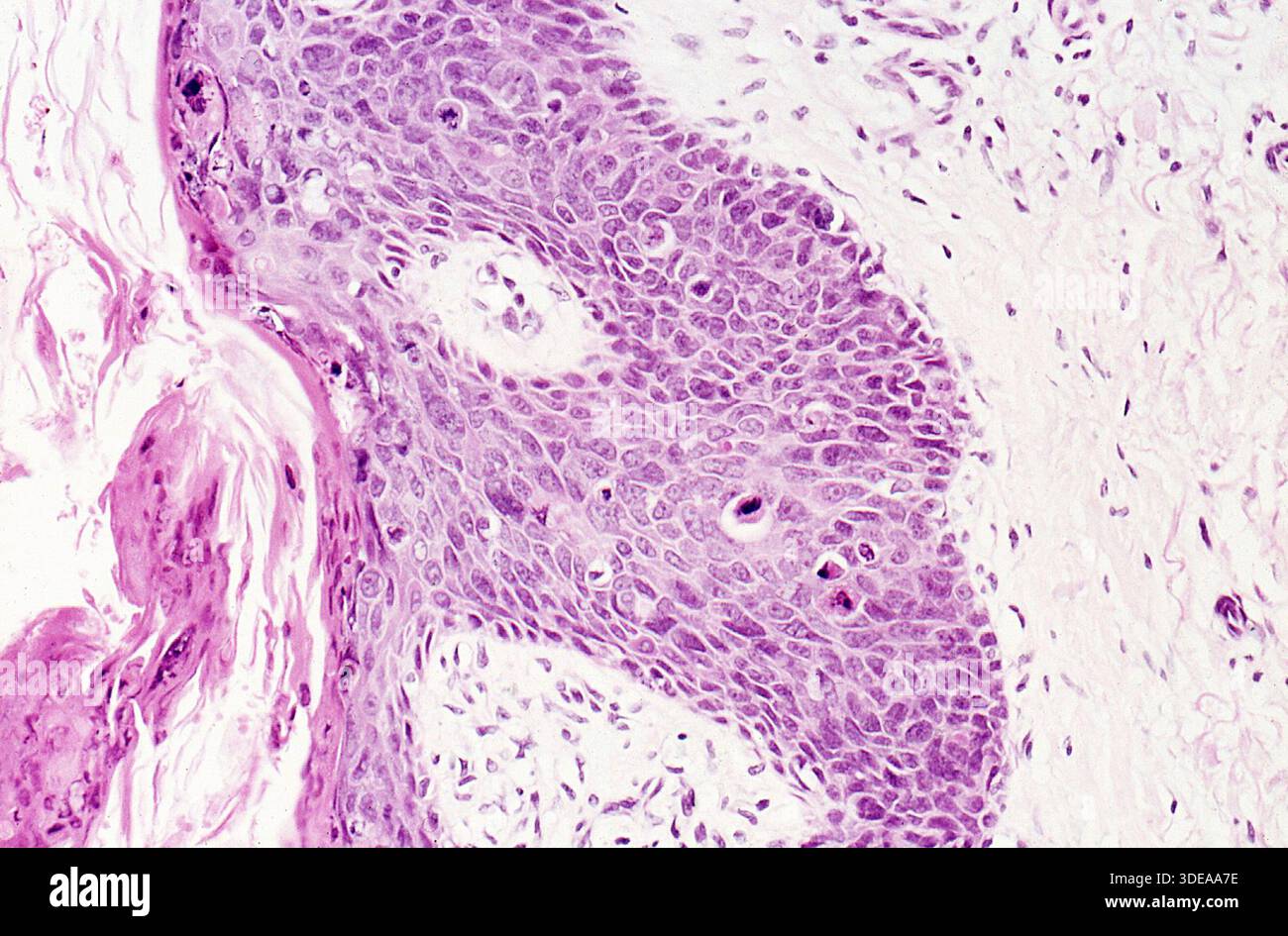 Intraepidermal carcinoma (ICE), Bowen's disease, skin cancer under the ...
