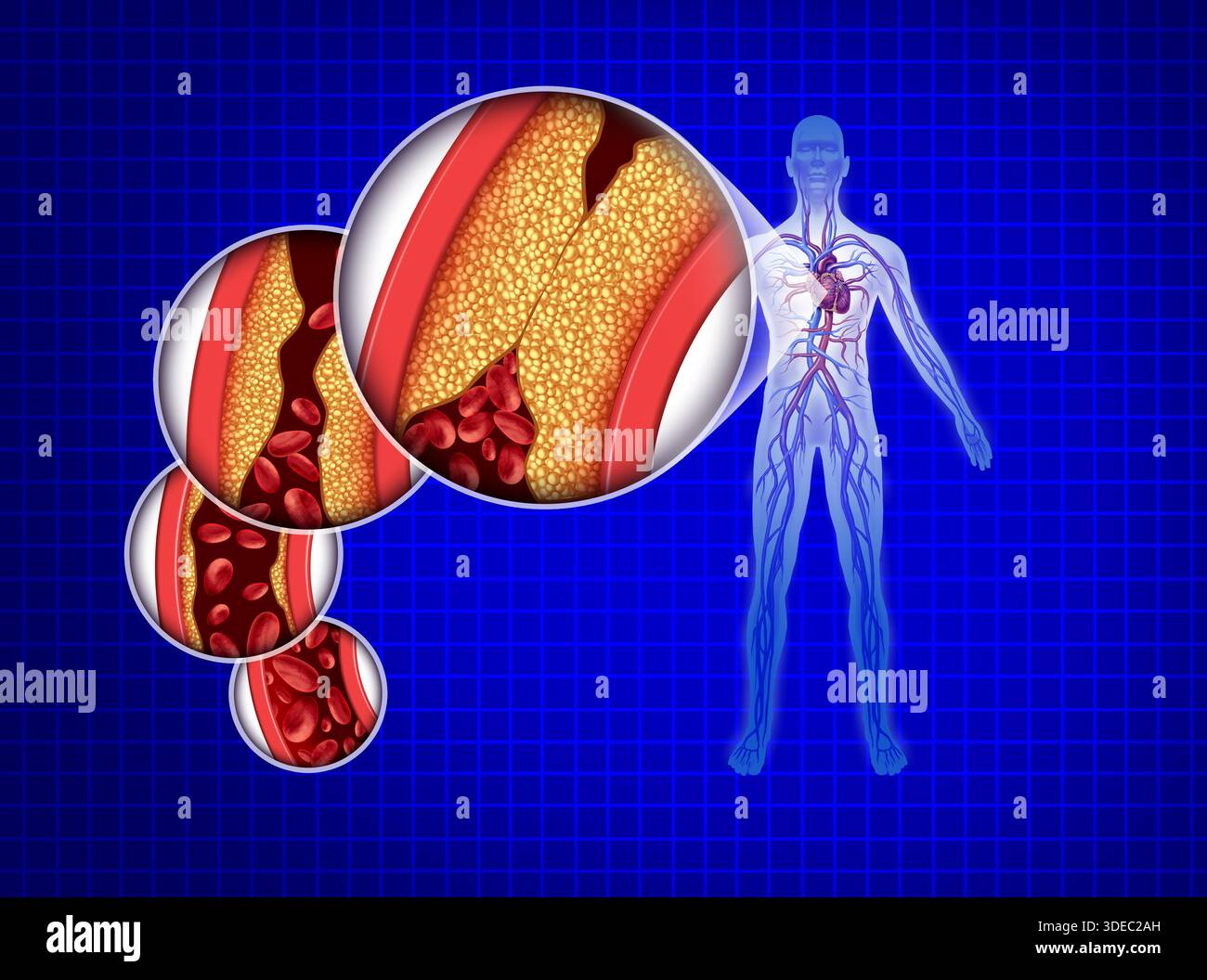 Blocked Human Cardiovascular Circulation and atherosclerosis as a heart ...