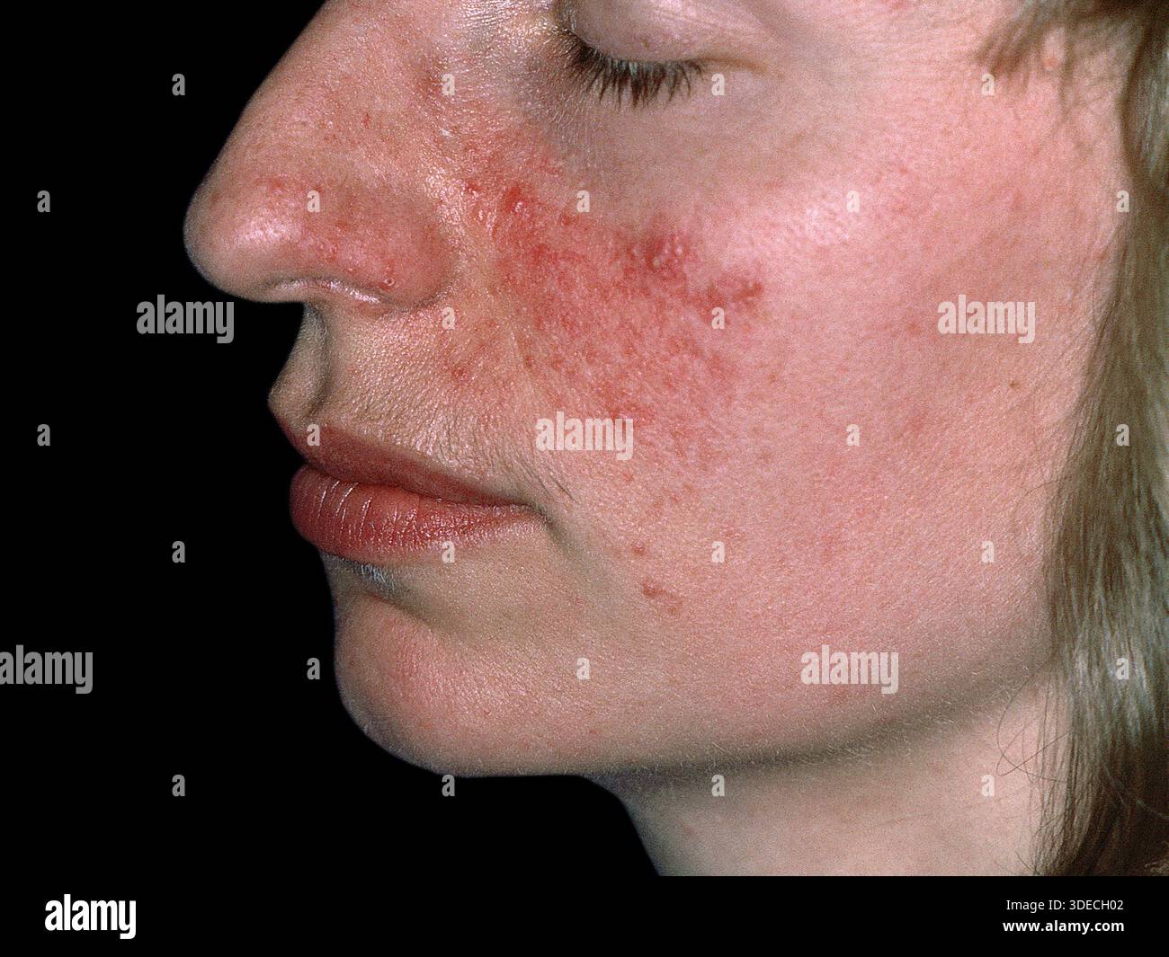 Acne rosacea on the face of a 25 year old woman. Rosacea is a chronic ...