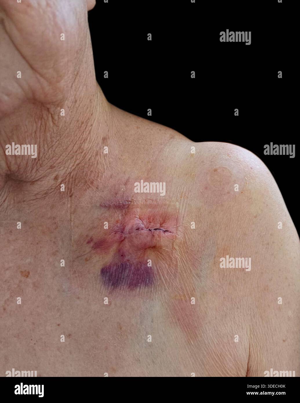 Post-operative scar and haematoma following pacemaker insertion surgery ...