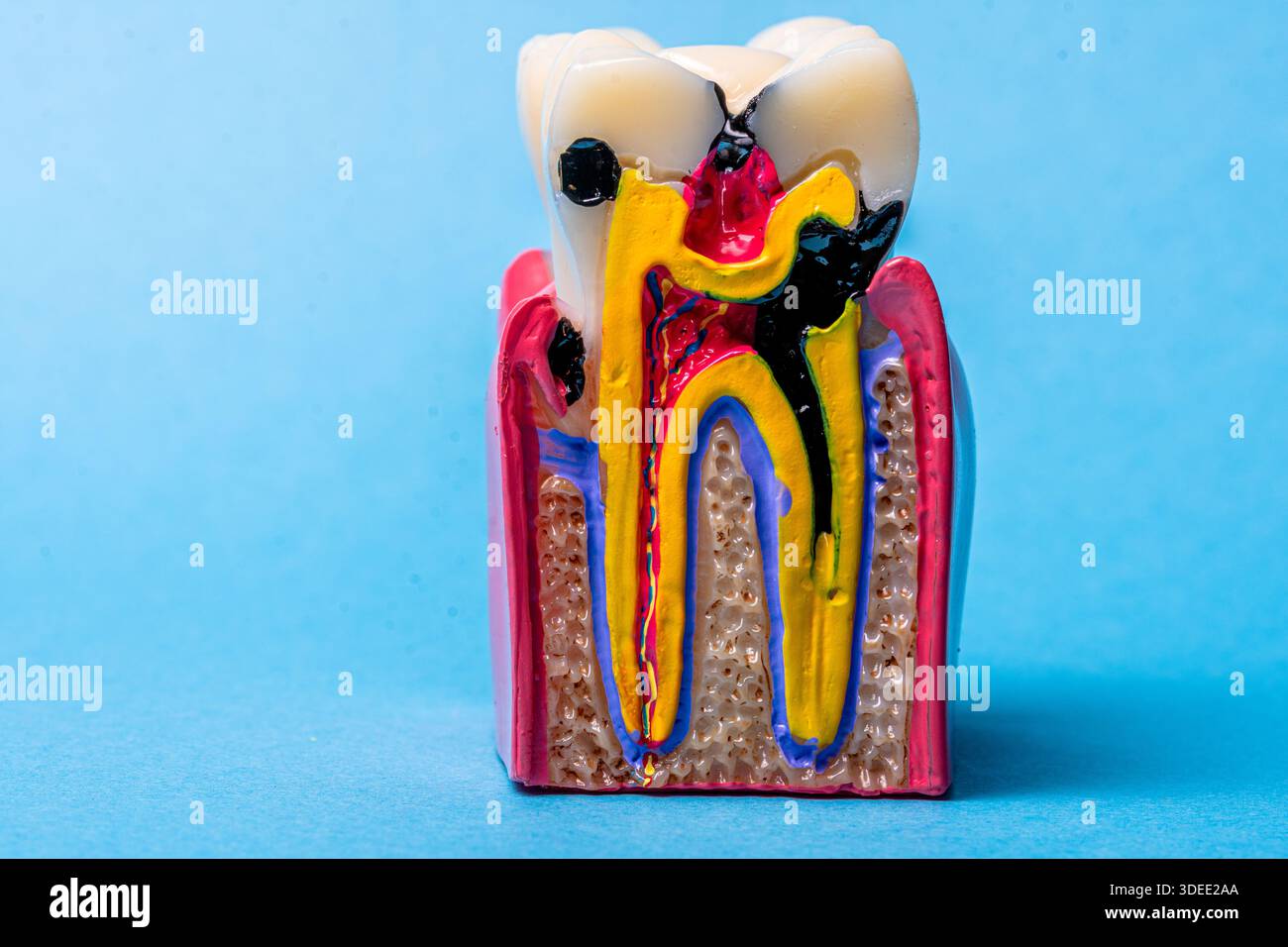 Dental tooth model showing anatomy and caries decay Stock Photo - Alamy