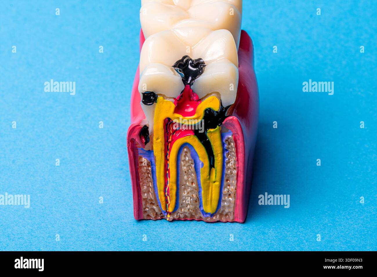 Dental tooth model showing severe decay and root canal Stock Photo - Alamy
