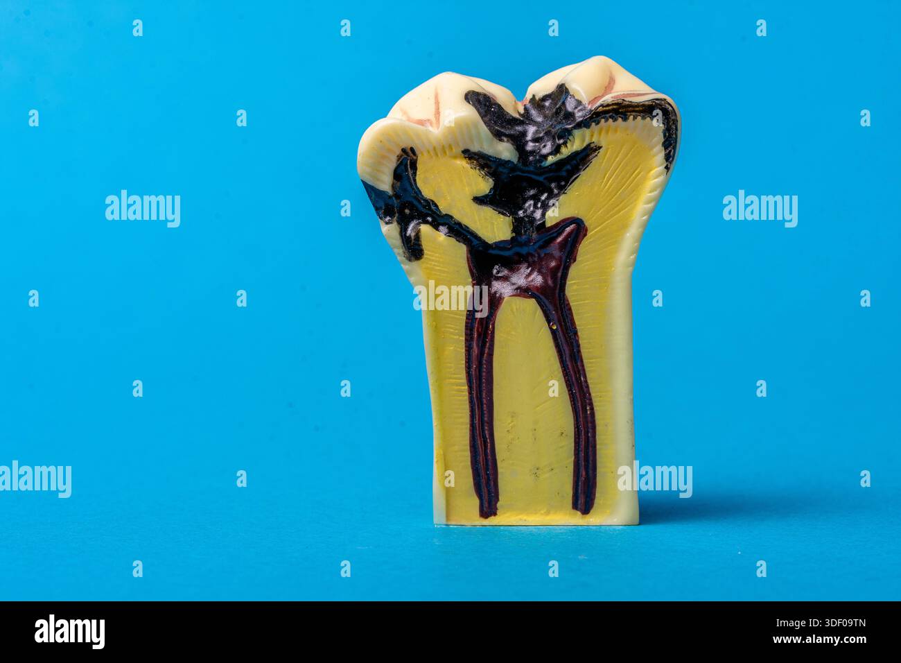 Human tooth enamel and pulp illustrating decay process Stock Photo - Alamy