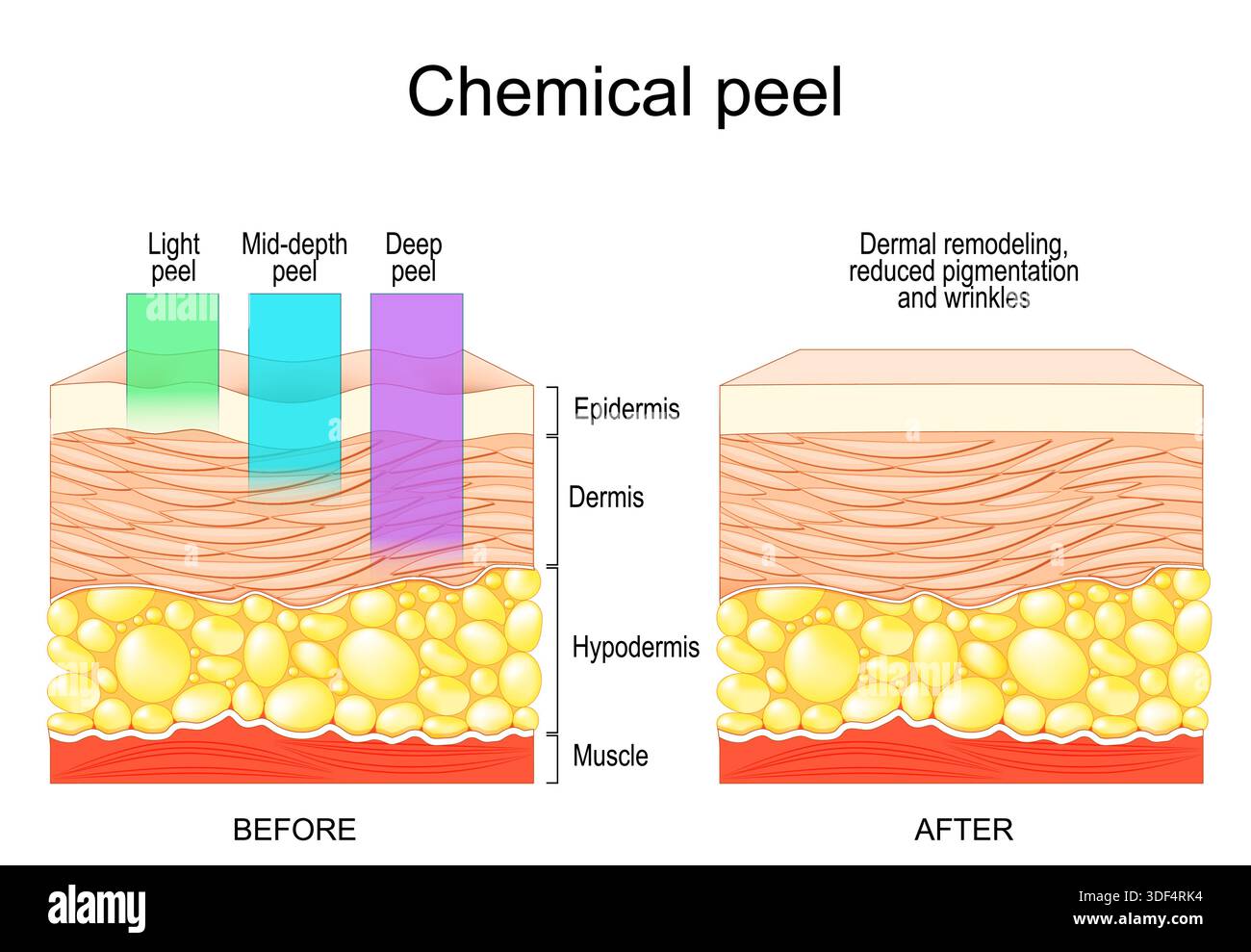 Chemical peeling. Human skin Before and after exfoliation ...