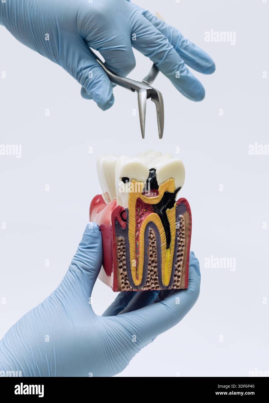 Gloved hands holding a cross-section tooth model with severe decay ...