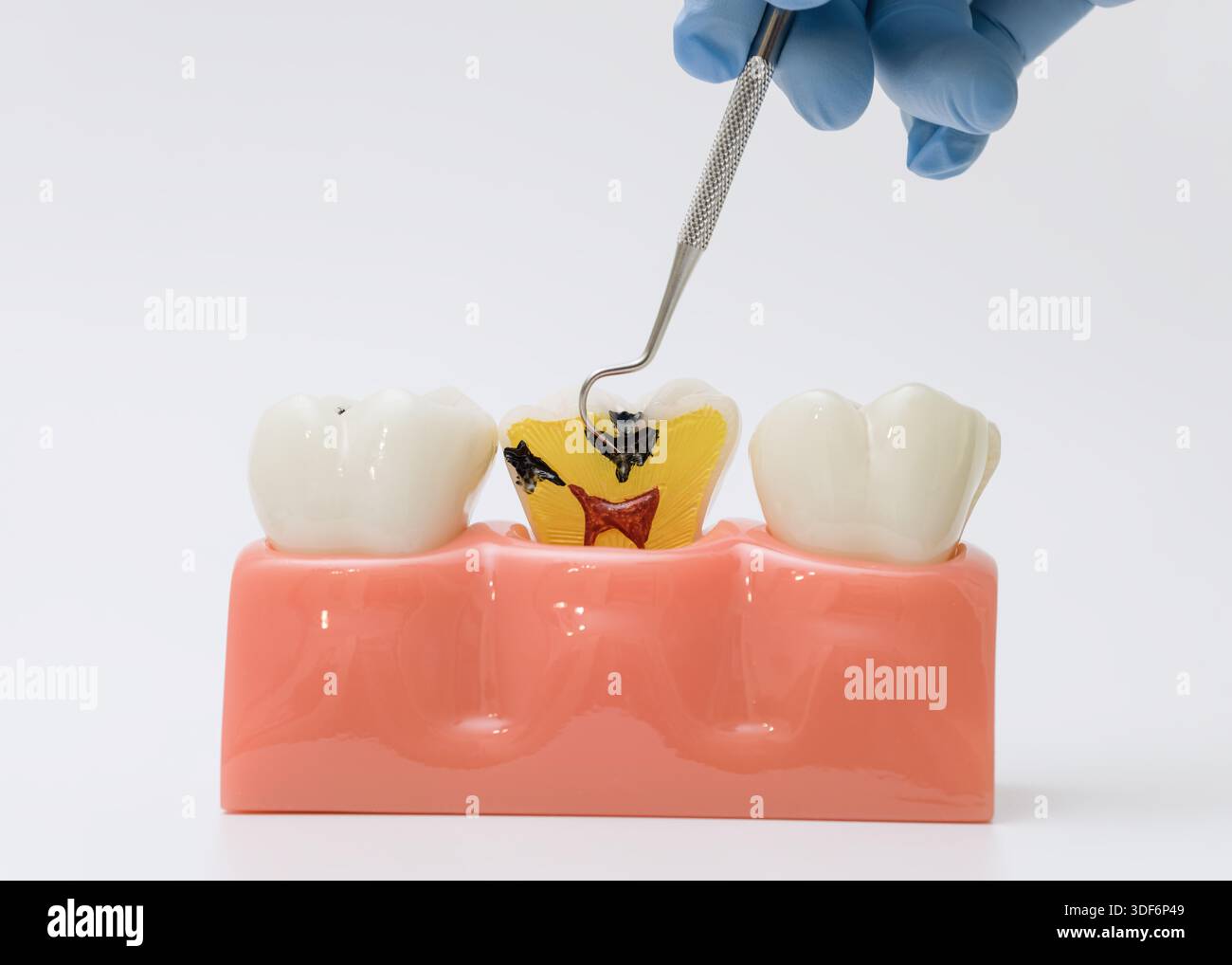 Deep caries hi-res stock photography and images - Alamy