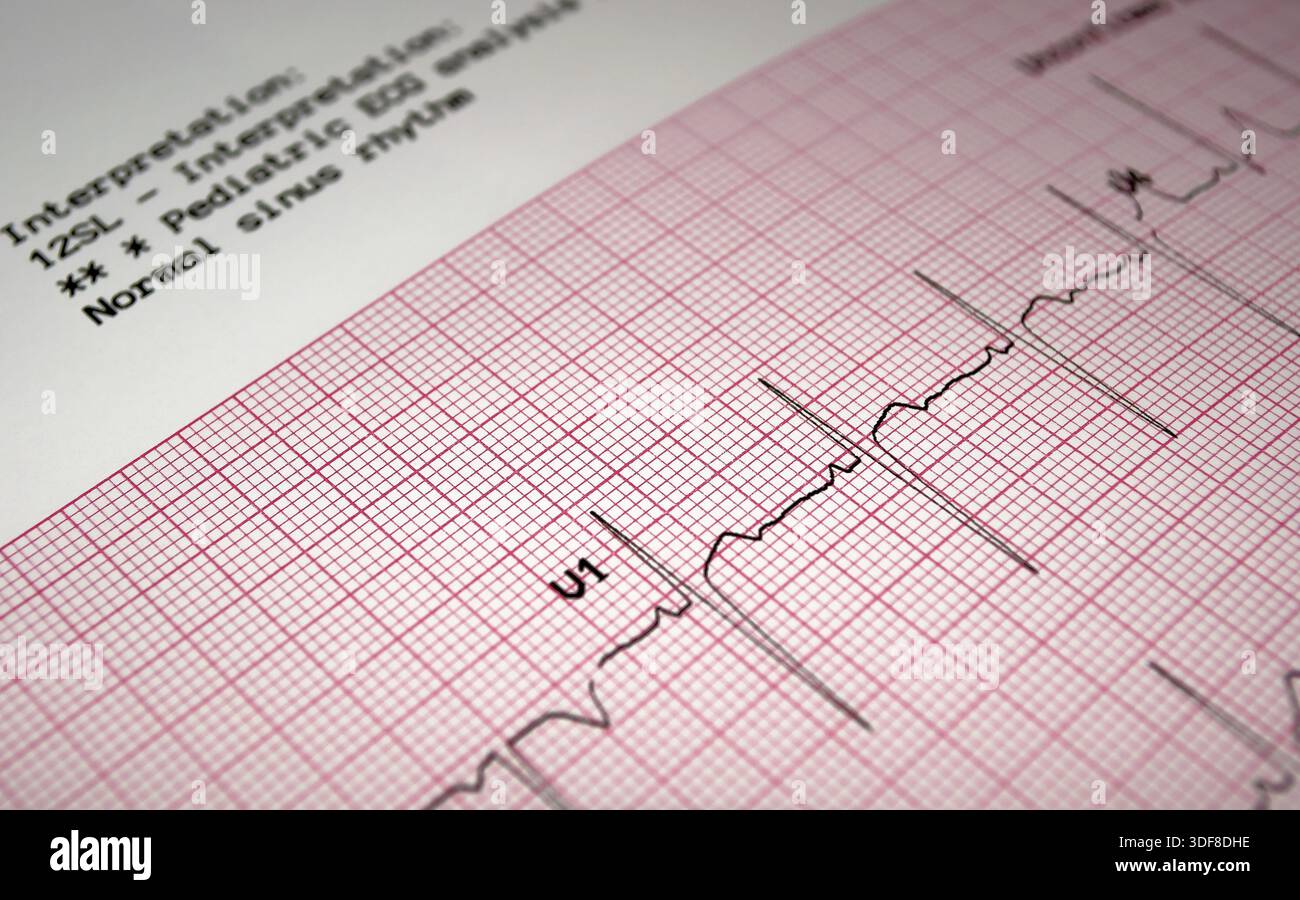 Heart analysis, ECG graph, pediatric electrocardiogram Stock Photo - Alamy