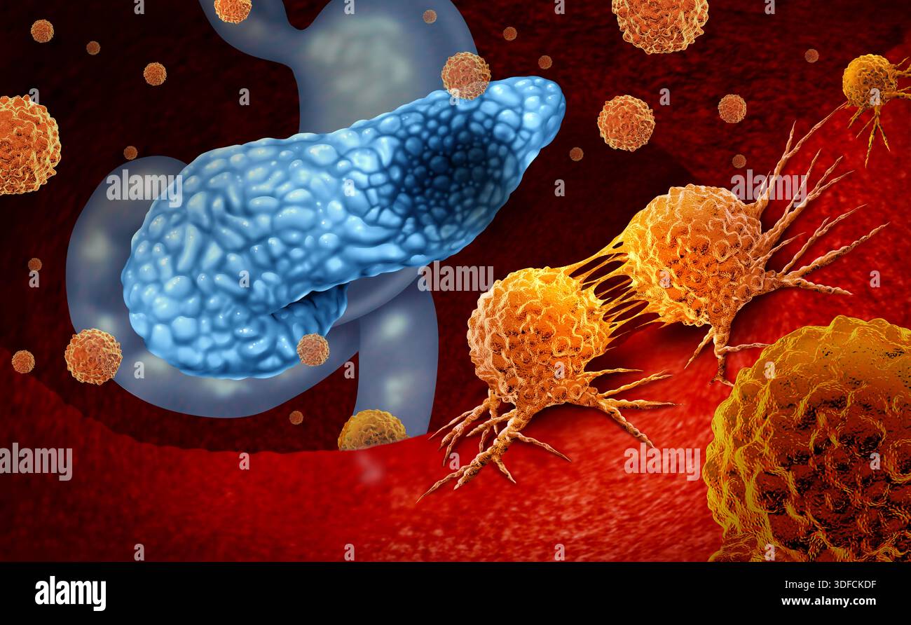 Pancreatic cancer anatomy concept and Pancreas malignant tumor symbol ...